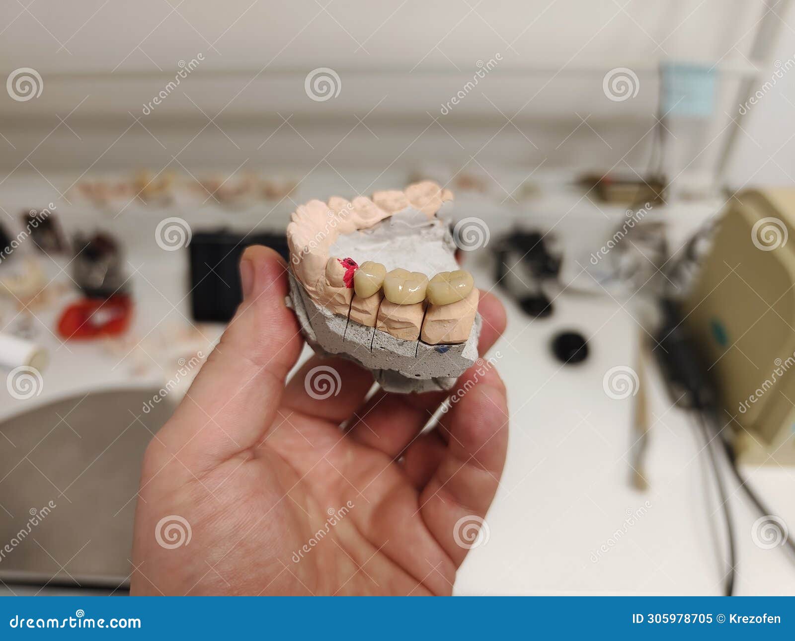 Technician Dental is Working with Complete Metal Ceramic Prosthesis ...