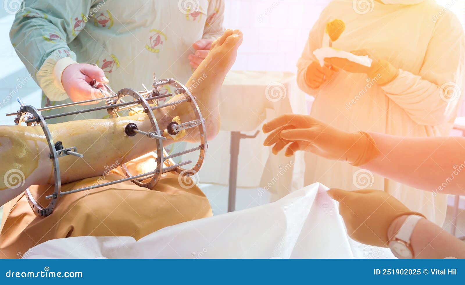 Technique of External Fixation with Rings in Orthopedic Medicine Stock ...