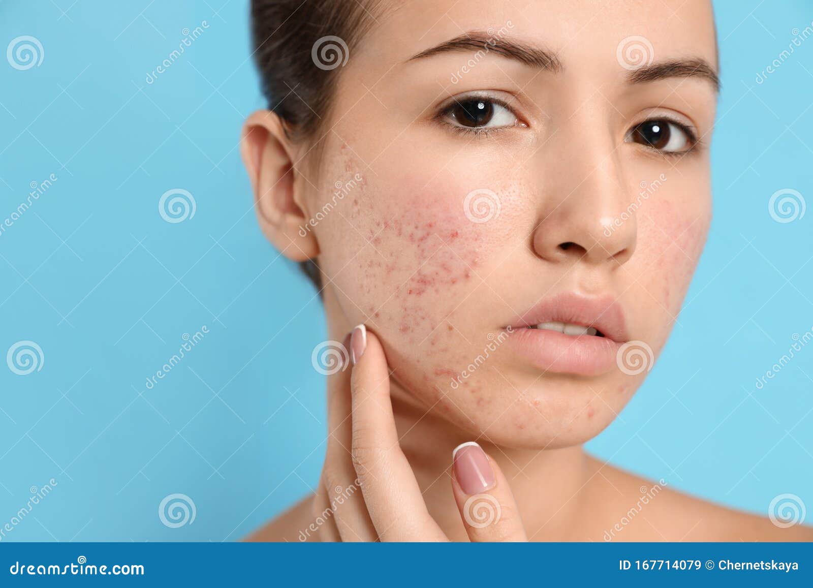 Teen Girl with Acne Problem on Blue Background Stock Image - Image of ...