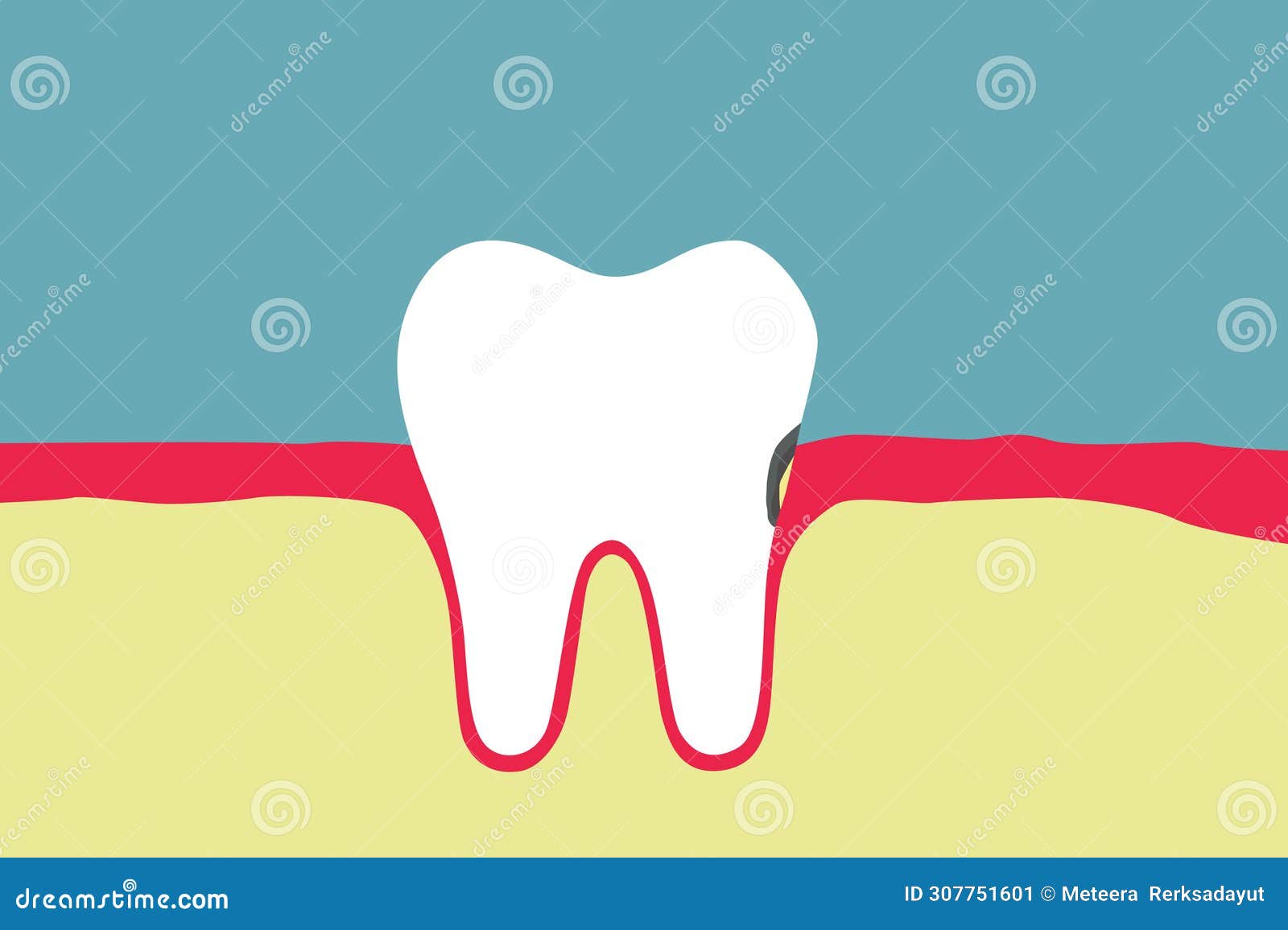 Plaque is a Sticky Biofilm that Develops on Teeth As a Result of the ...