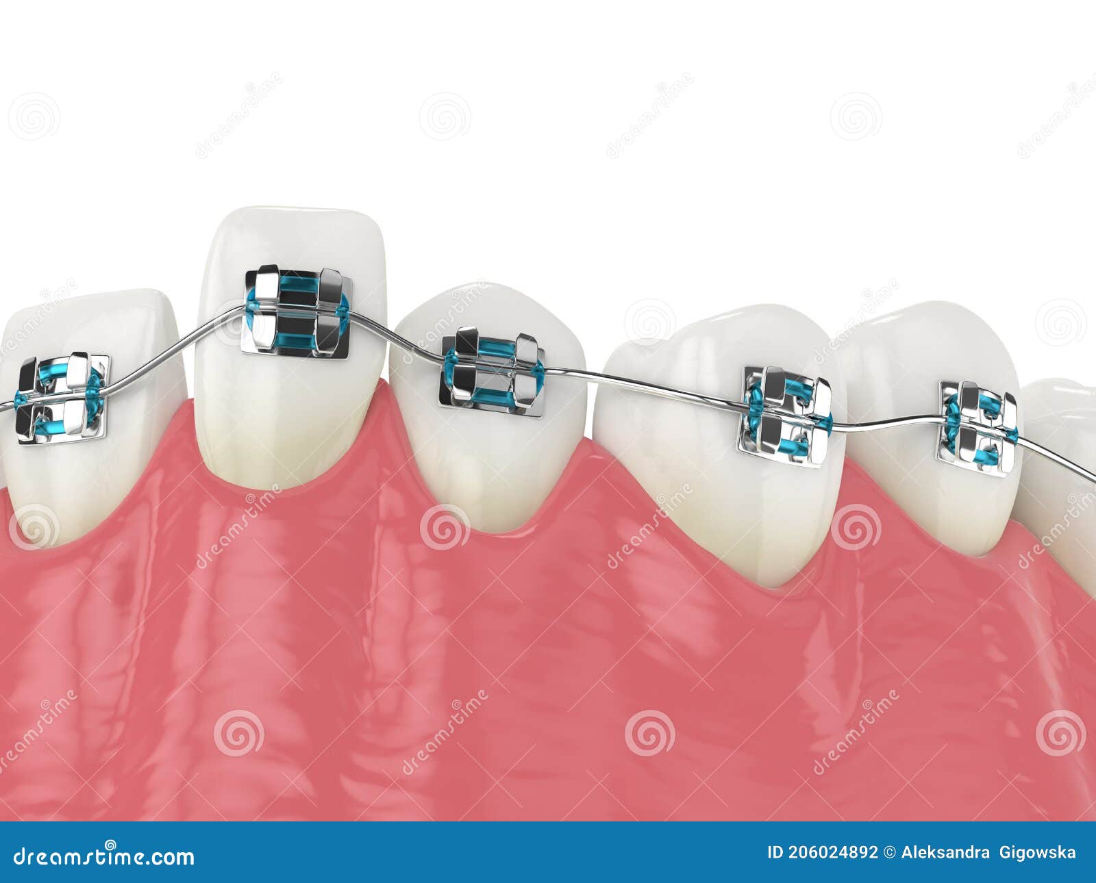 Teeth Alignment by Orthodontic Braces Isolated Over White Background ...