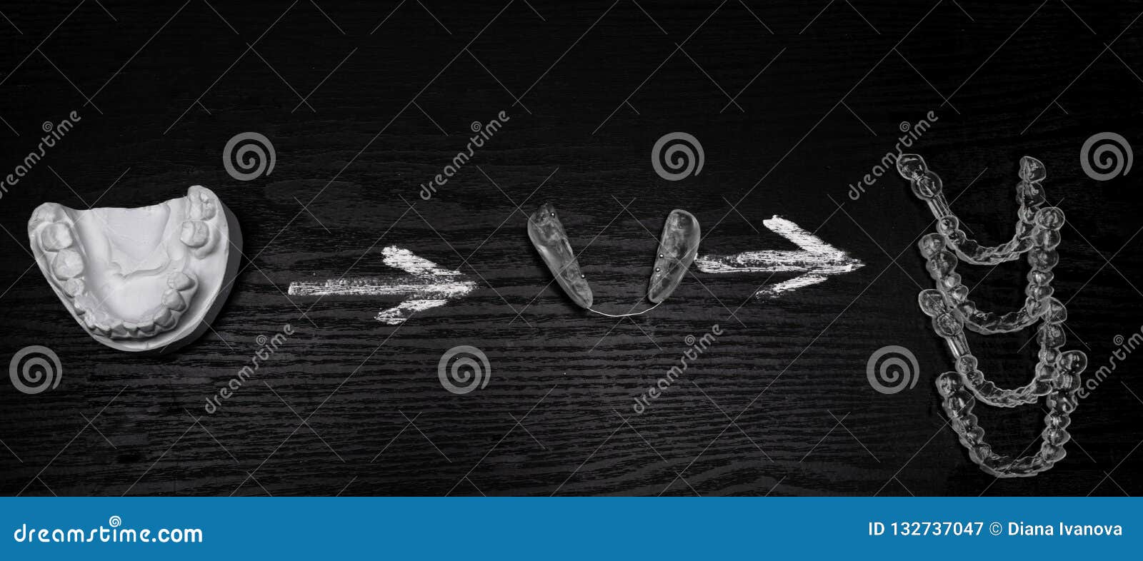 Teeth Alignment Stages Process, Gypsum Cast, Different Aligners Stock ...