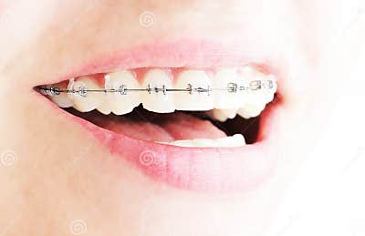 Teeth with braces stock image. Image of closeup, female - 18632133