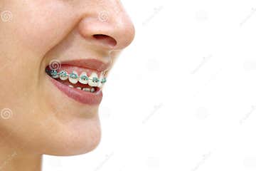 Teeth Braces stock photo. Image of clean, dentist, bracket - 3327752