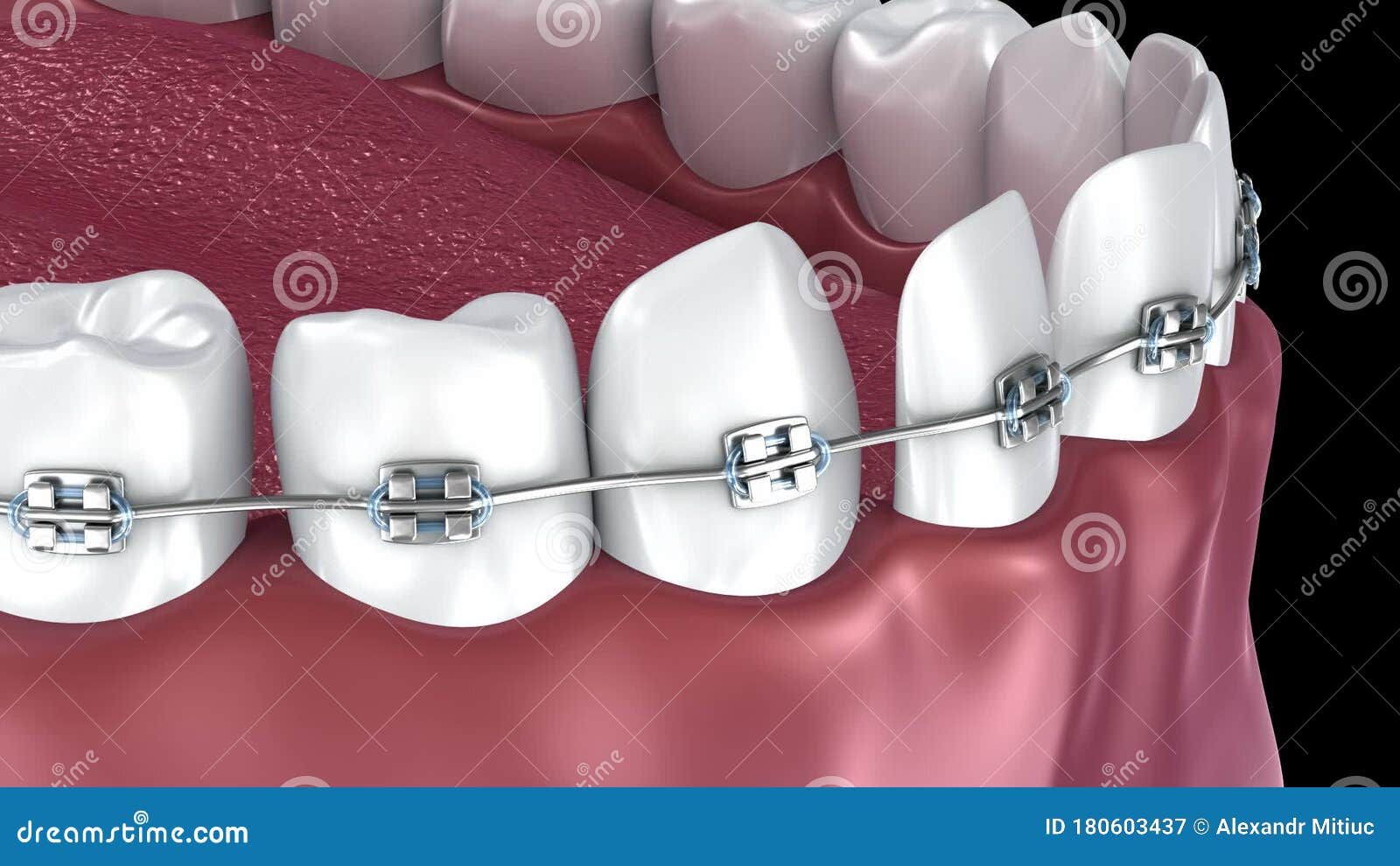 Teeth with Braces Alignment Process Stock Video - Video of care ...