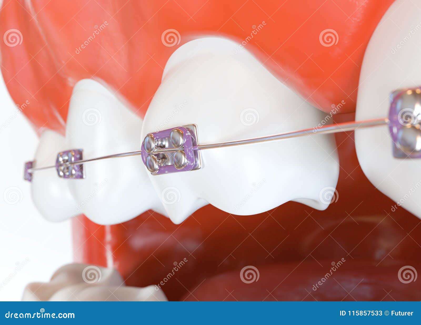 Teeth With Braces Or Brackets In Open Human Mouth - 3d Rendering ...