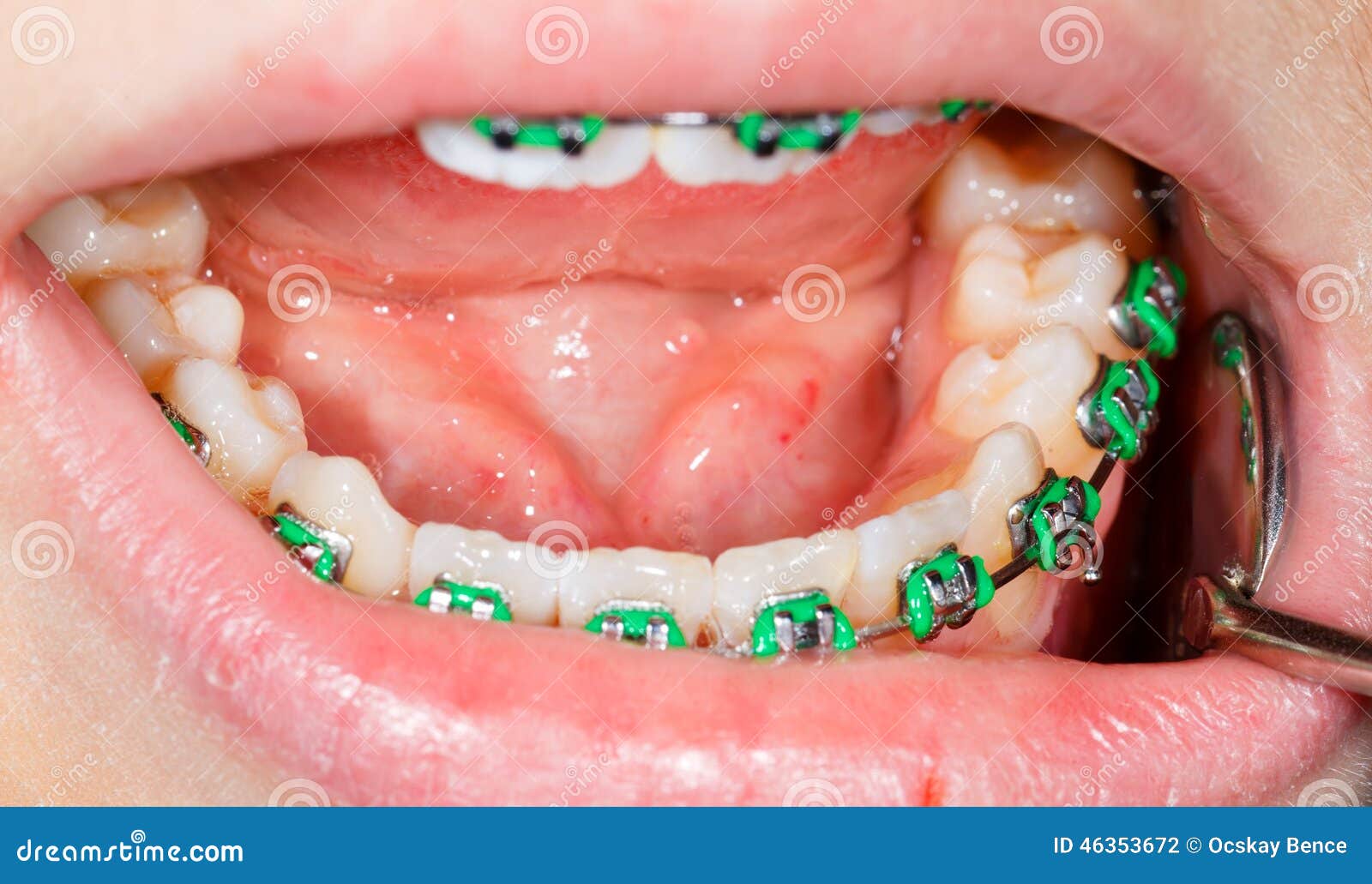Teeth with braces stock photo. Image of orthodontia, beautiful - 46353672