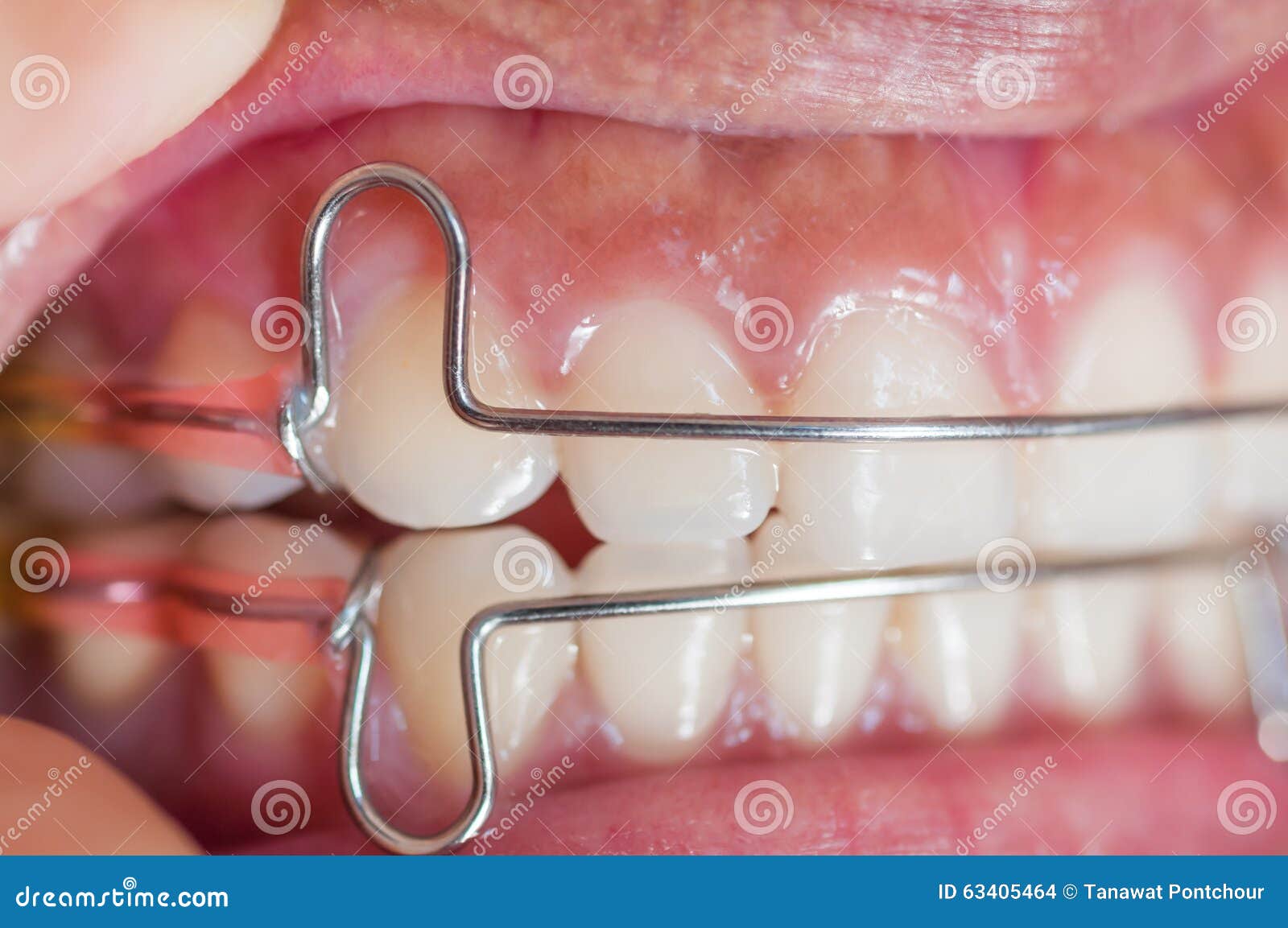 Teeth with braces. stock photo. Image of girl, mouth - 63405464