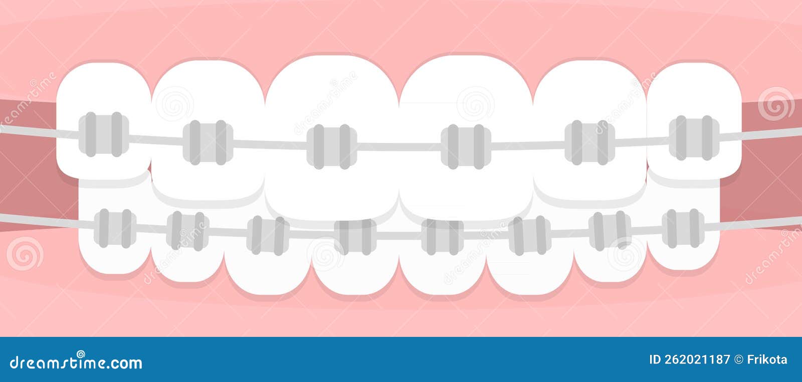 Teeth Braces. Concept of Orthodontics. Horizontal Format. Vector ...