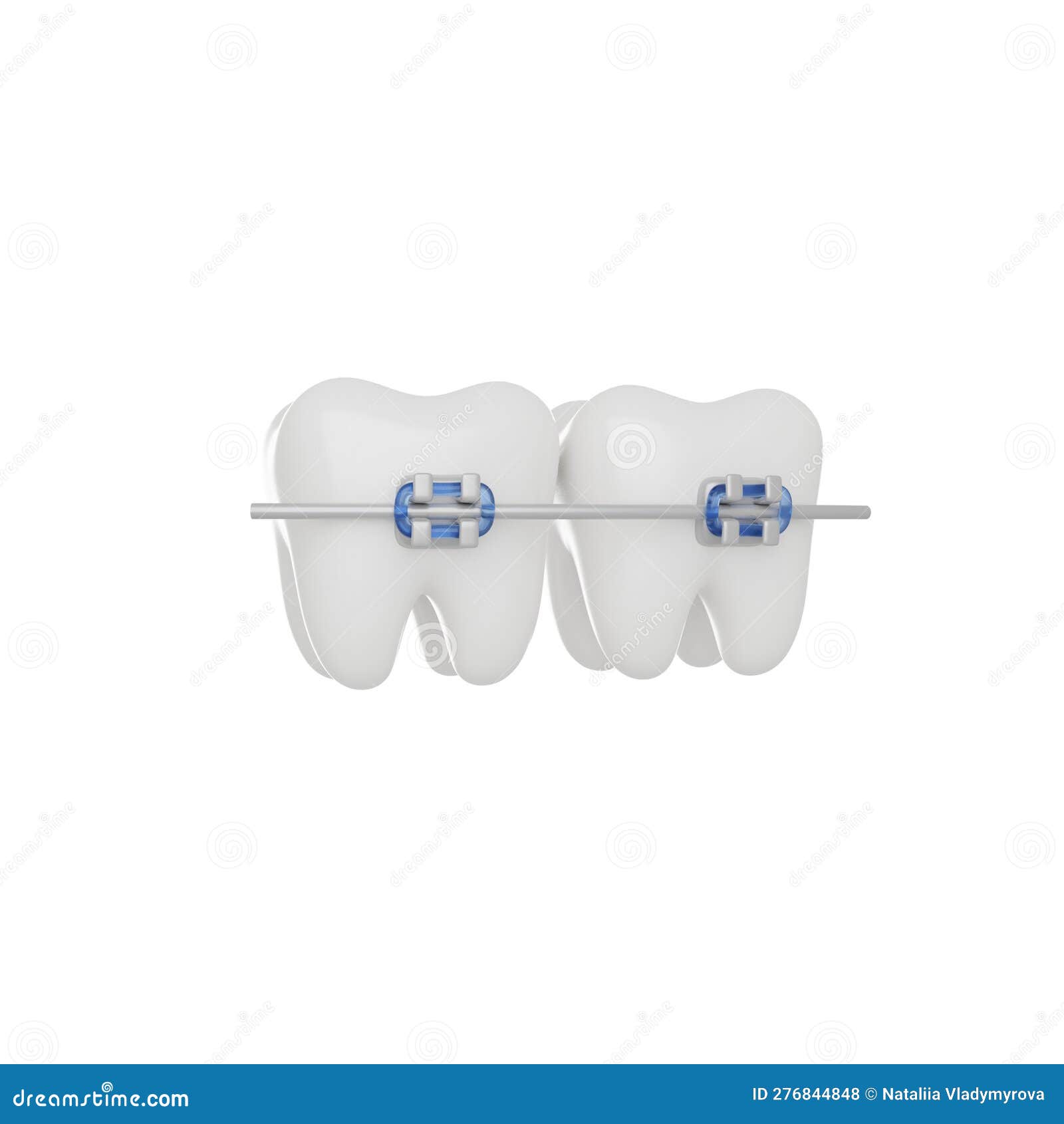 Teeth With Braces Or Brackets In Open Human Mouth. Dental Care Stock ...
