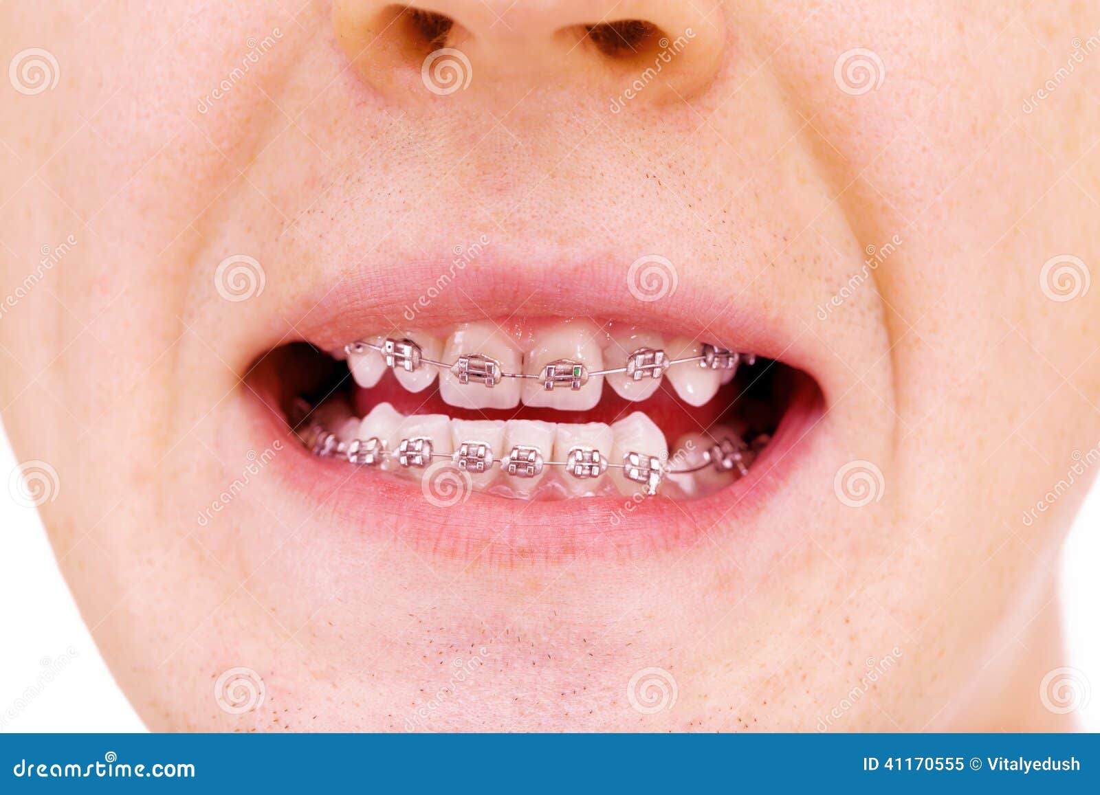 Teeth with Braces. Isolated Stock Image - Image of handsome, macro ...