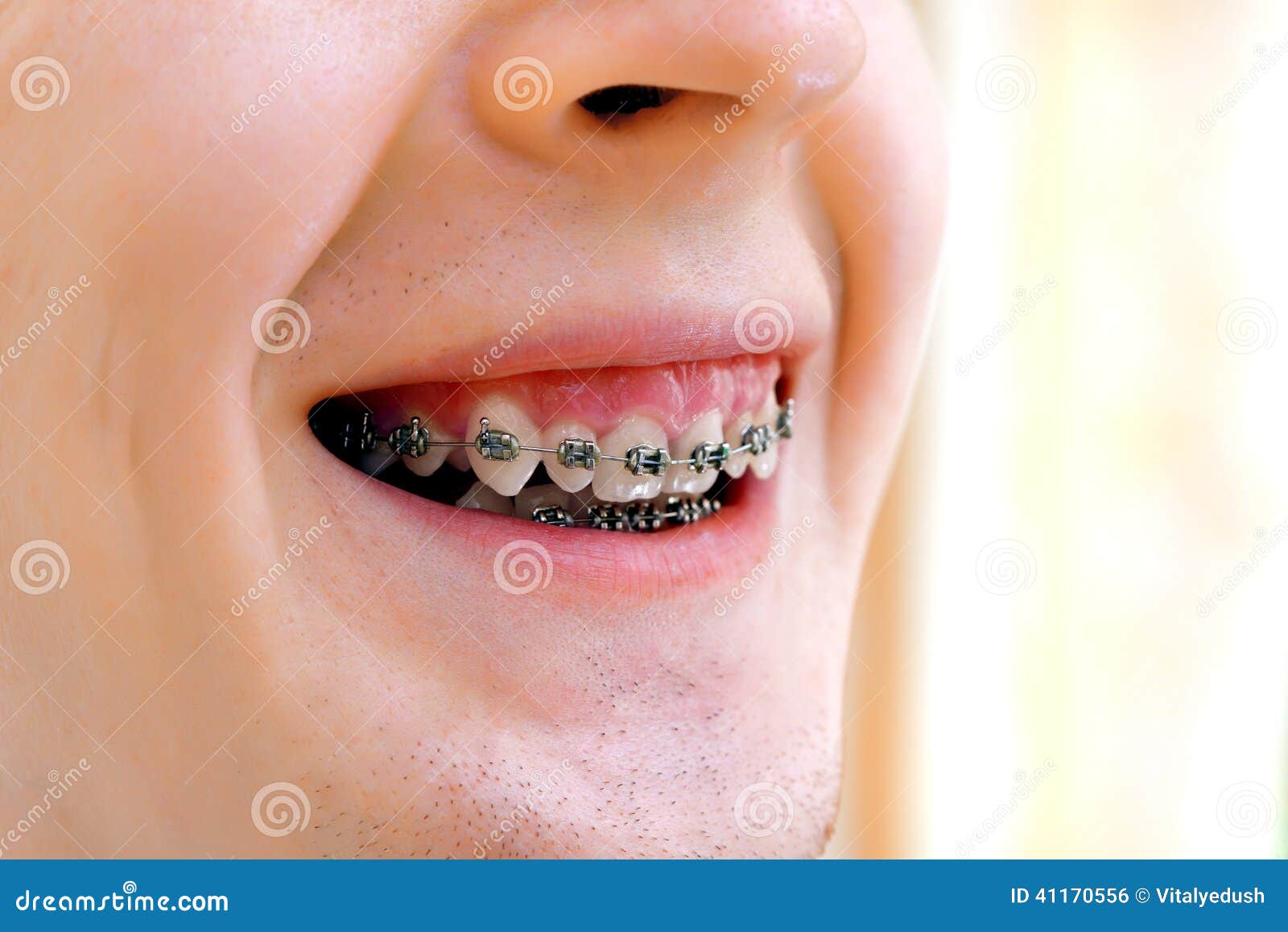 Teeth with Braces. Isolated Stock Photo - Image of handsome, casual ...