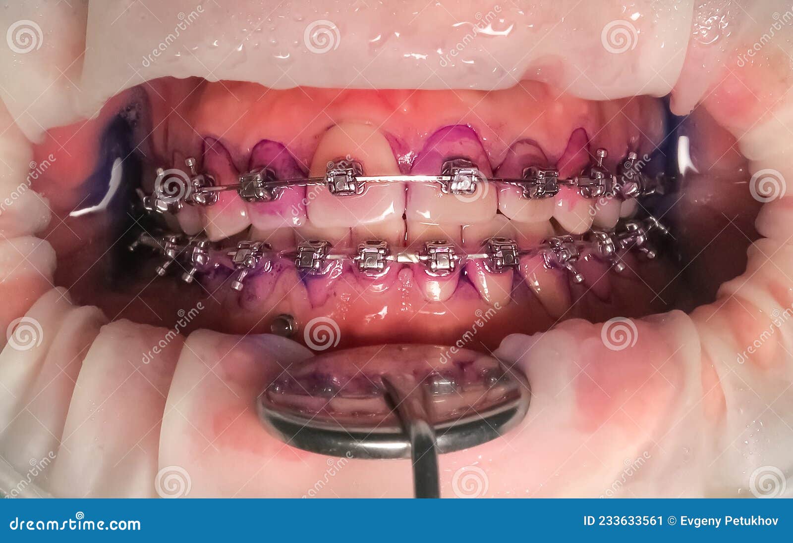 Teeth in Braces. the Result of Tablets To Detect Bacteria or Plaque on ...