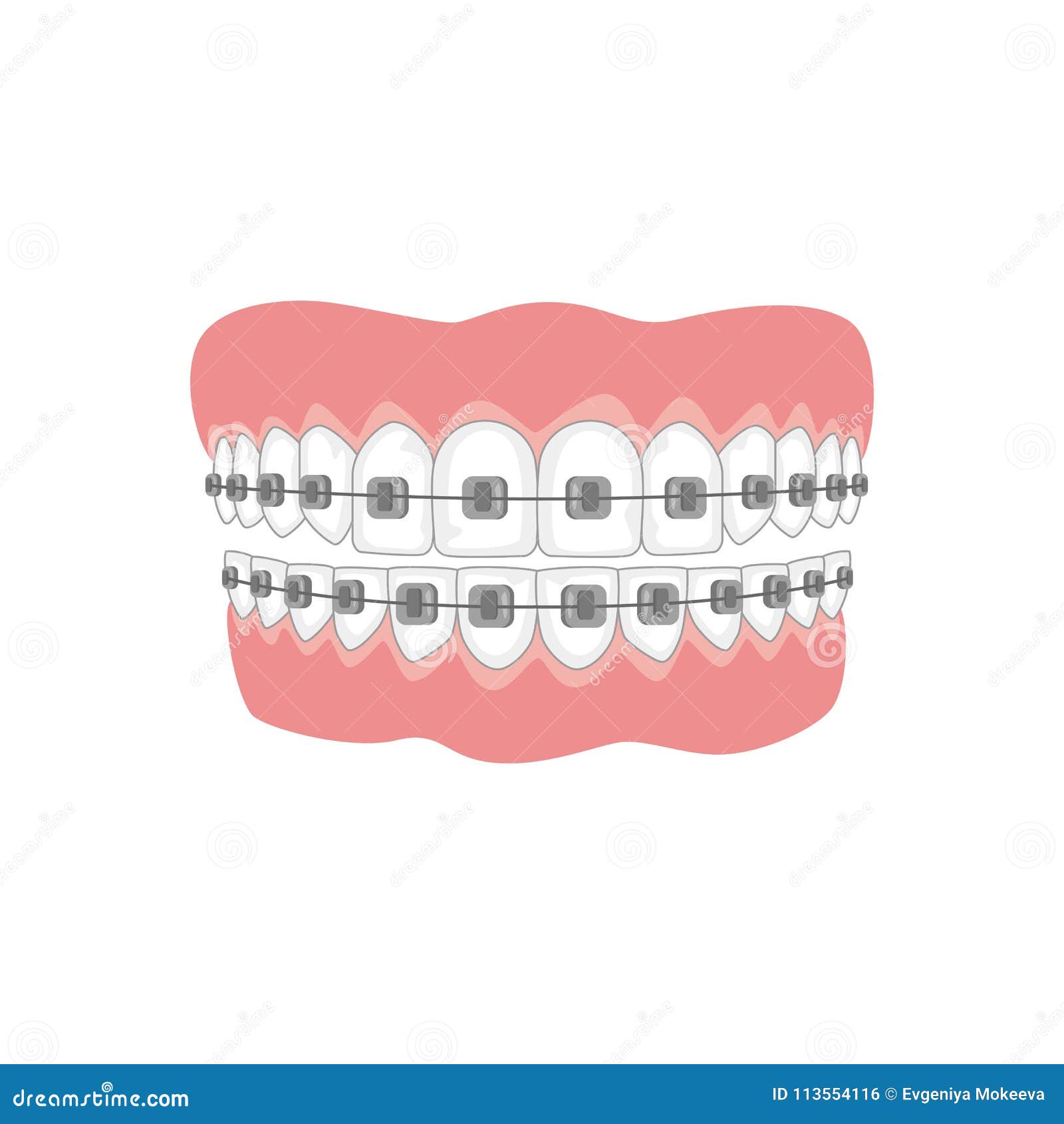 Teeth with Braces on White Background. Stock Vector - Illustration of ...