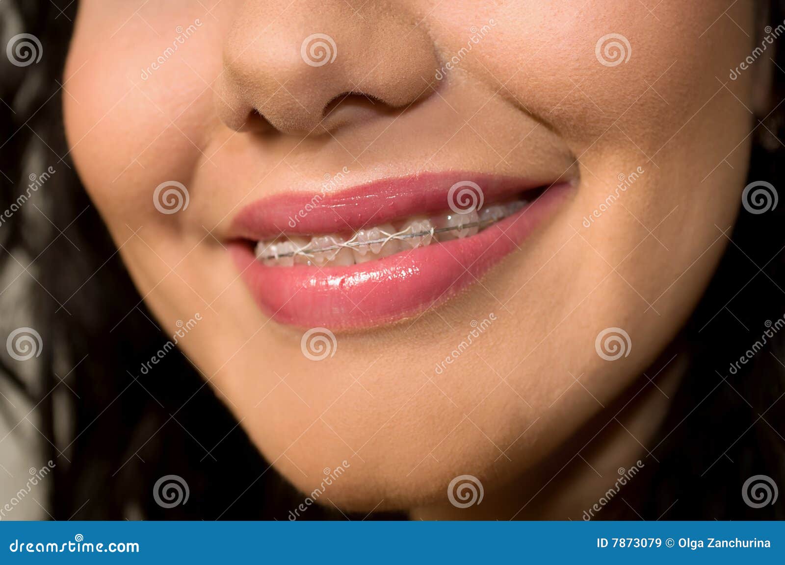 Teeth in brackets stock image. Image of grin, macro, healthcare - 7873079