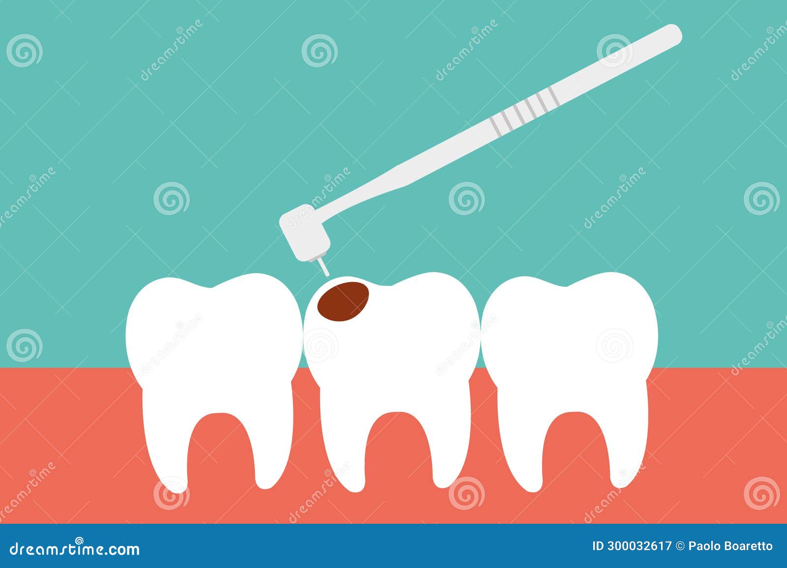 Tooth Cavity Filling Vector Illustration | CartoonDealer.com #116591302