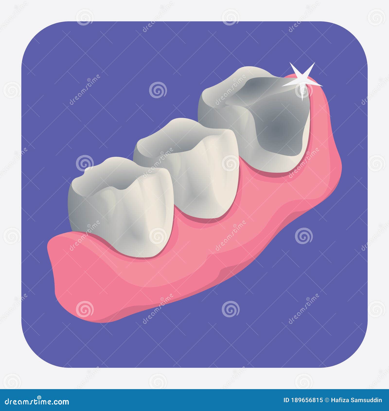 Teeth with Cavity. Vector Illustration Decorative Design Stock Vector ...