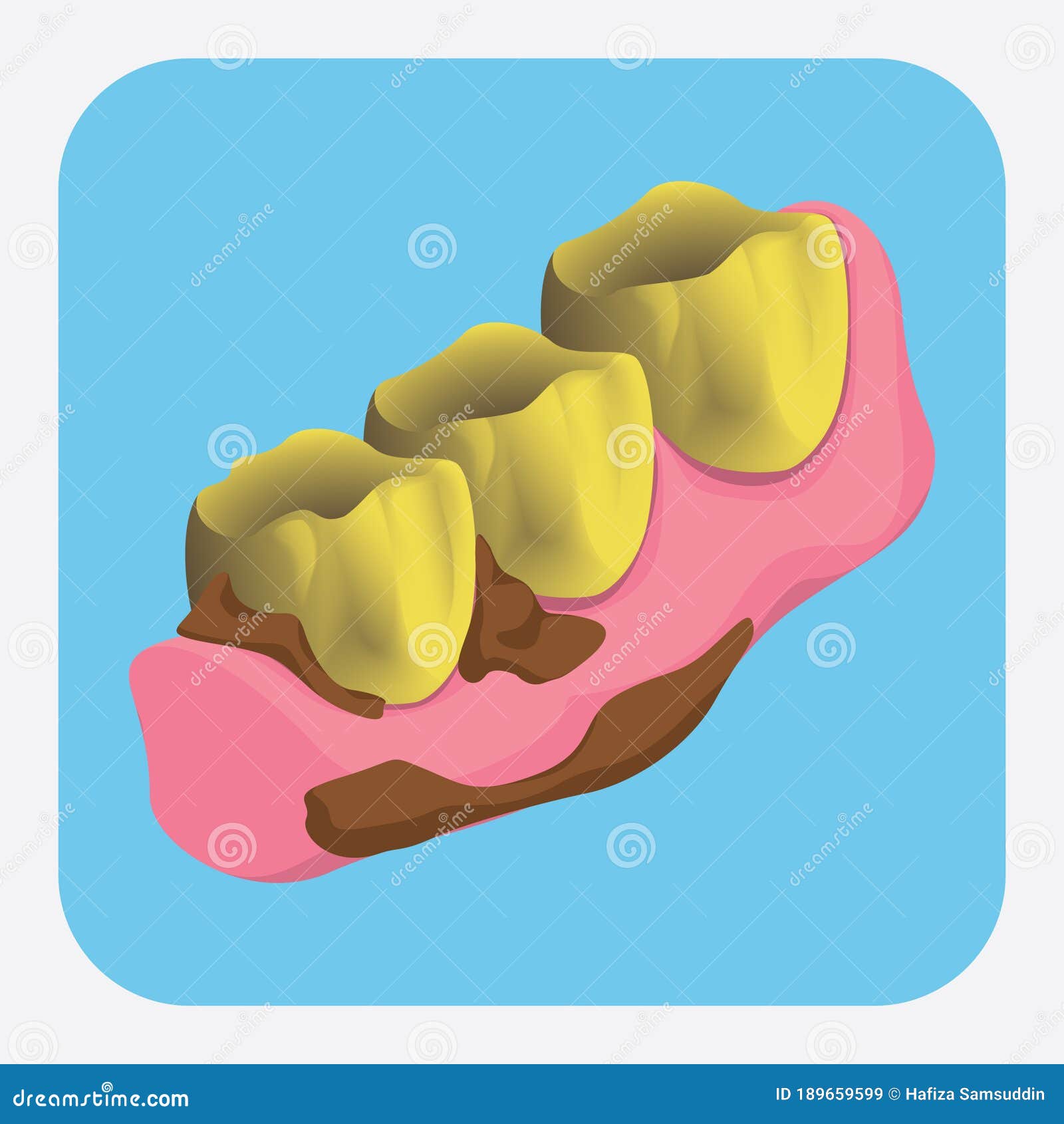 Teeth with Cavity. Vector Illustration Decorative Design Stock Vector ...