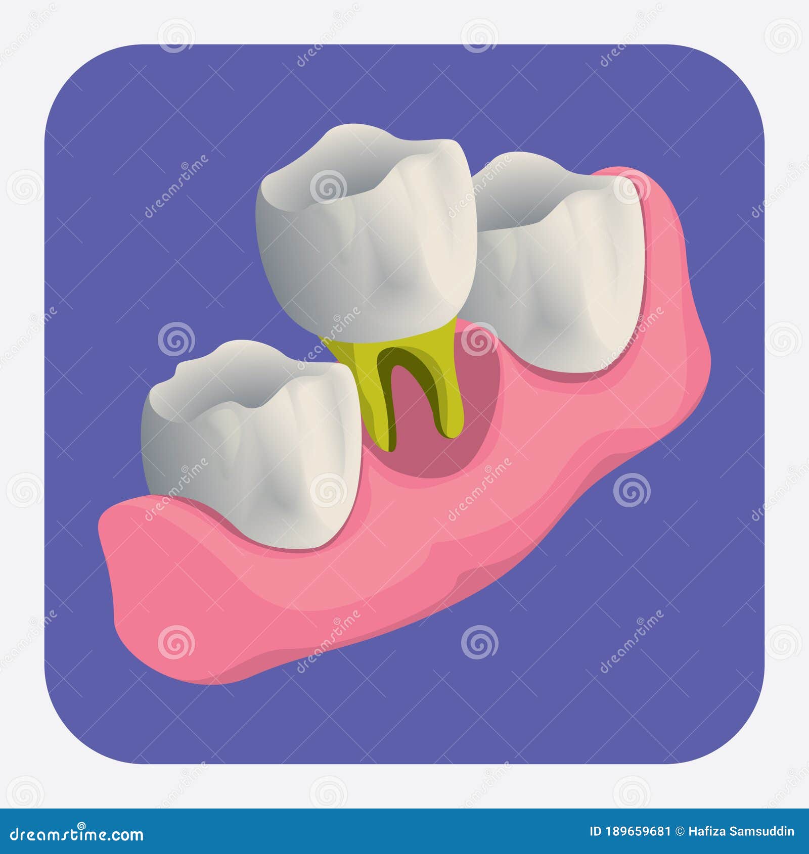 Teeth with Cavity. Vector Illustration Decorative Design Stock Vector ...