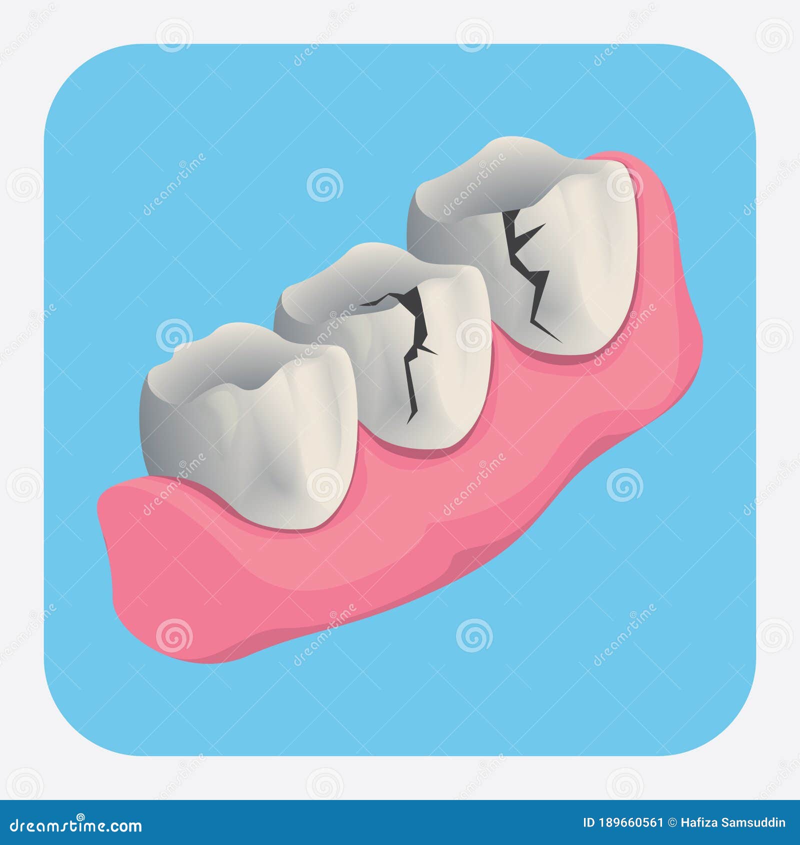 Teeth Crack Fracture, Tooth Carious Cavity Cartoon White, Health Dent ...
