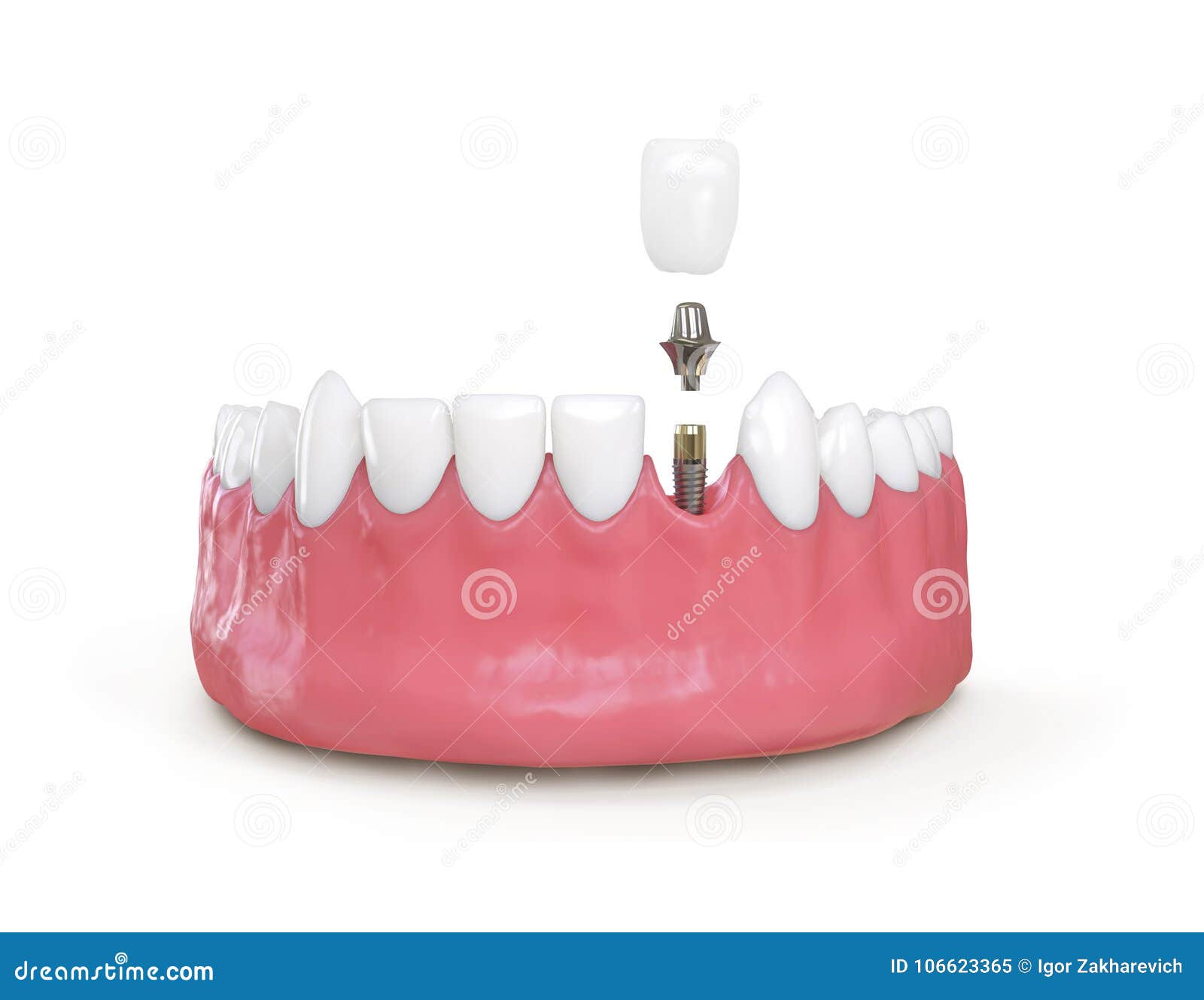 Row Of Teeth With Dental Implant - Teeth Prosthetics Scheme Vector ...