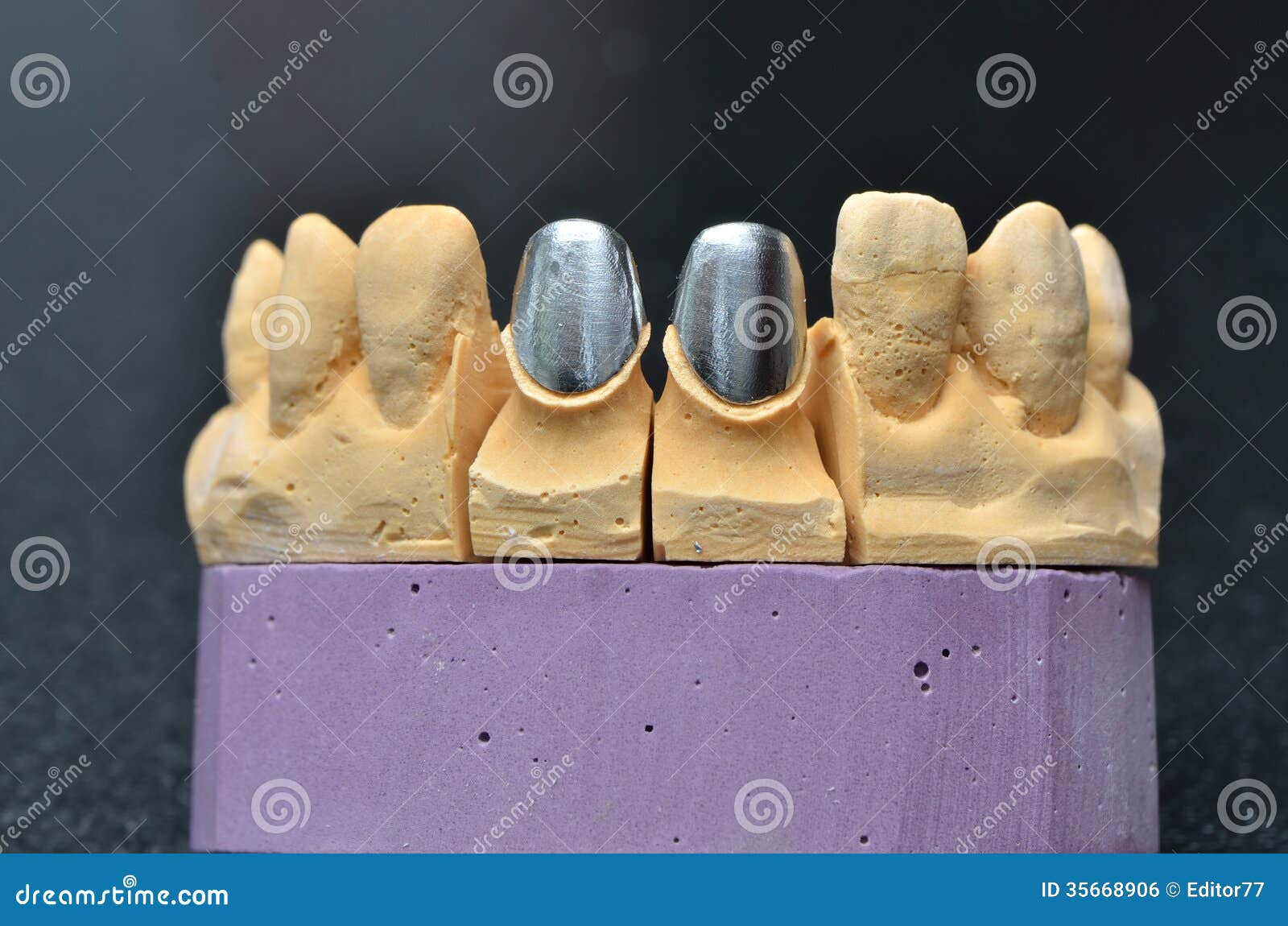 Teeth dental implant model stock photo. Image of implant - 35668906