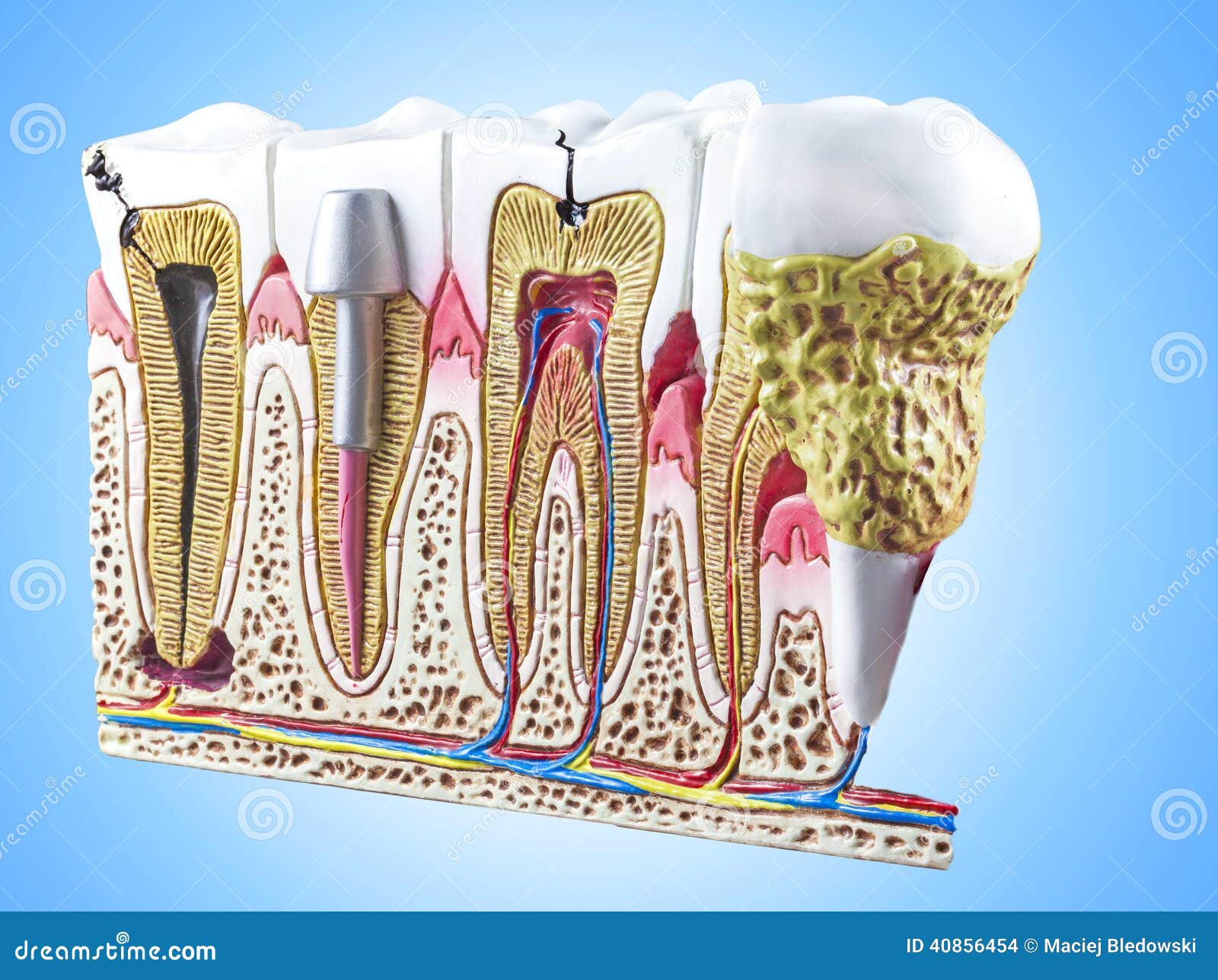 Teeth, Dental Section Model. Stock Photo - Image of oral, nerves: 40856454