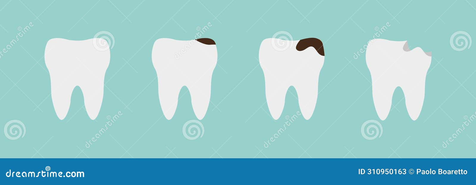 Teeth on Different Stages of Caries. Tooth Decay, Toothache. Deep ...