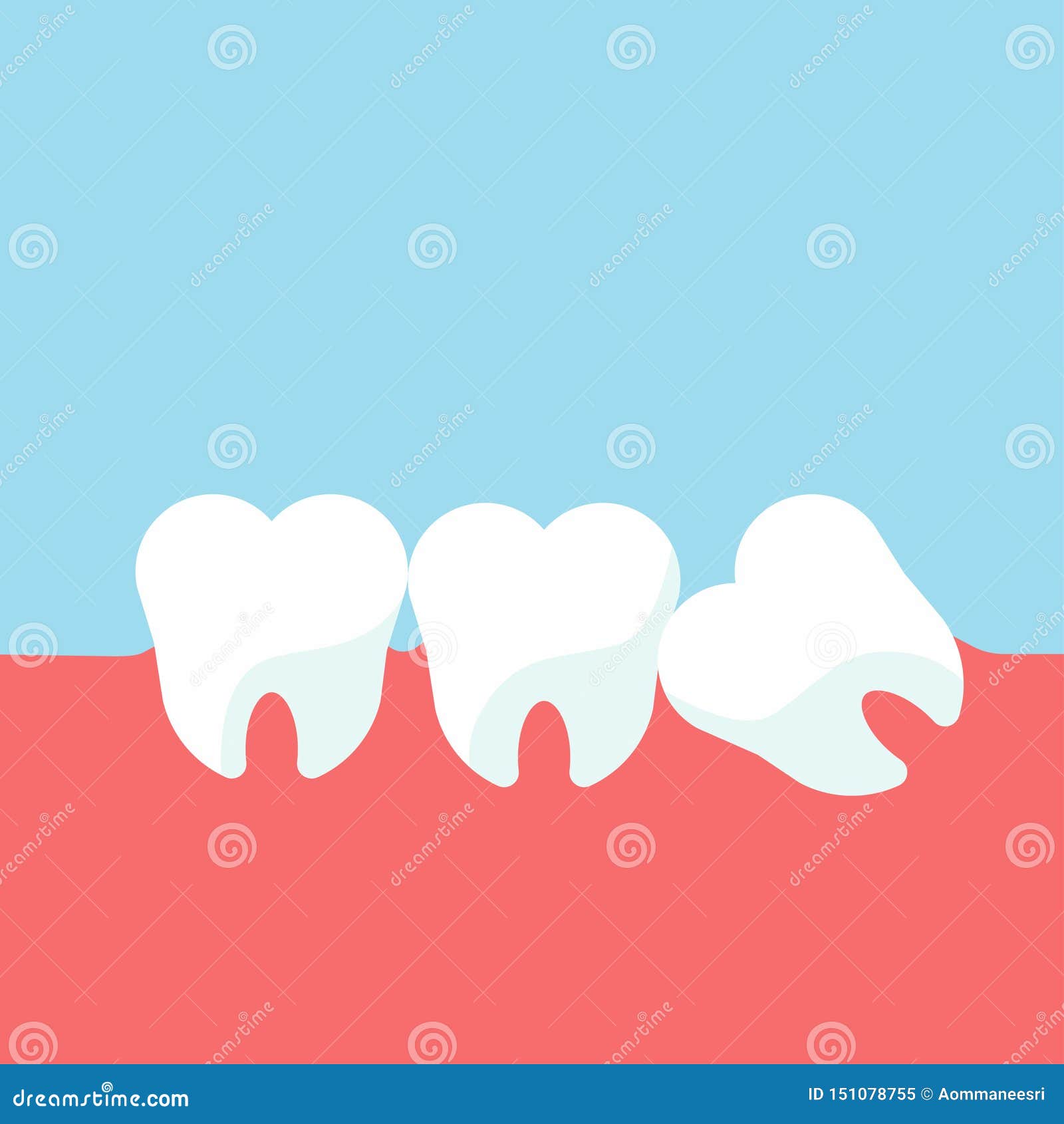 Impacted Wisdom Tooth In Cartoon Flat Style. Vector Illustration Of ...