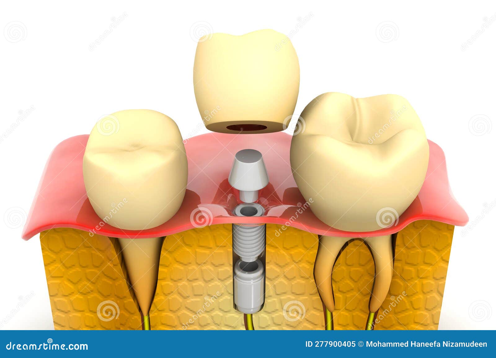 Teeth Implant Installation Process Stock Illustration - Illustration of ...