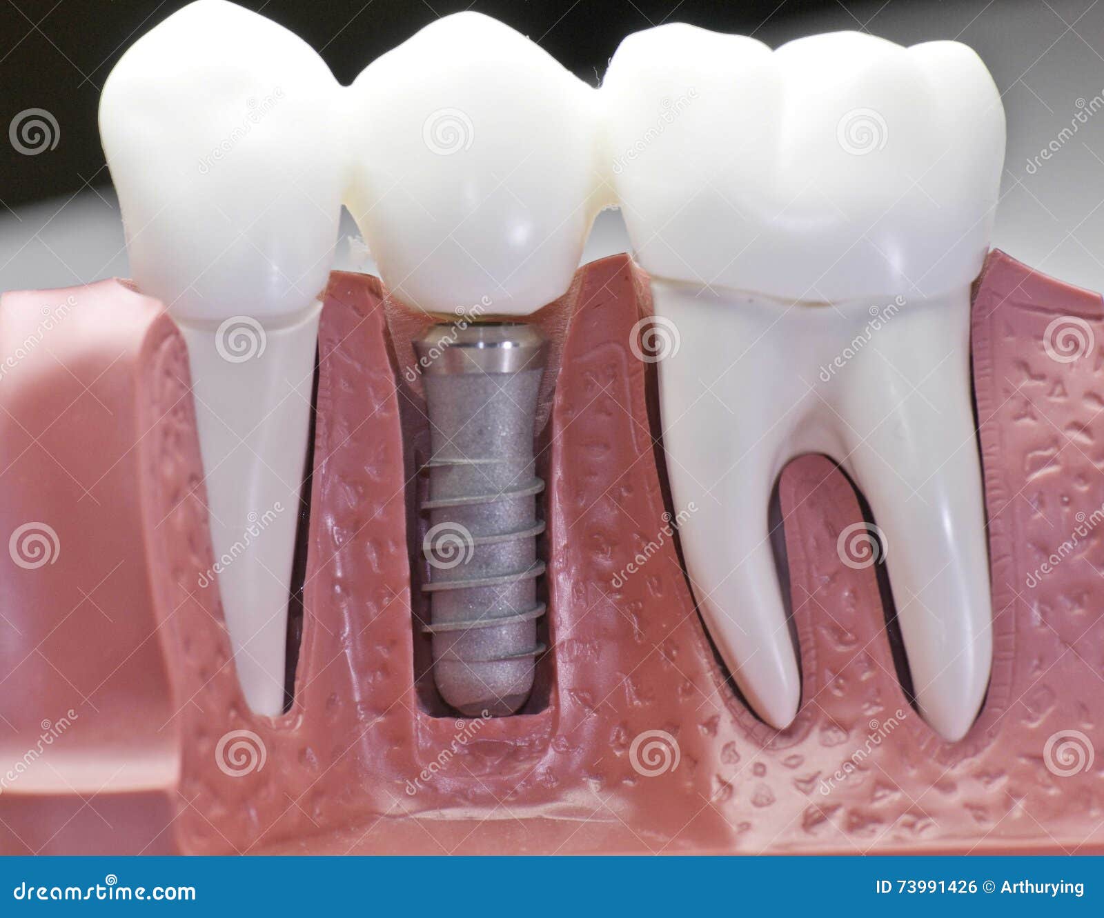 Teeth Implant stock photo. Image of sample, tooth, demonstrate - 73991426