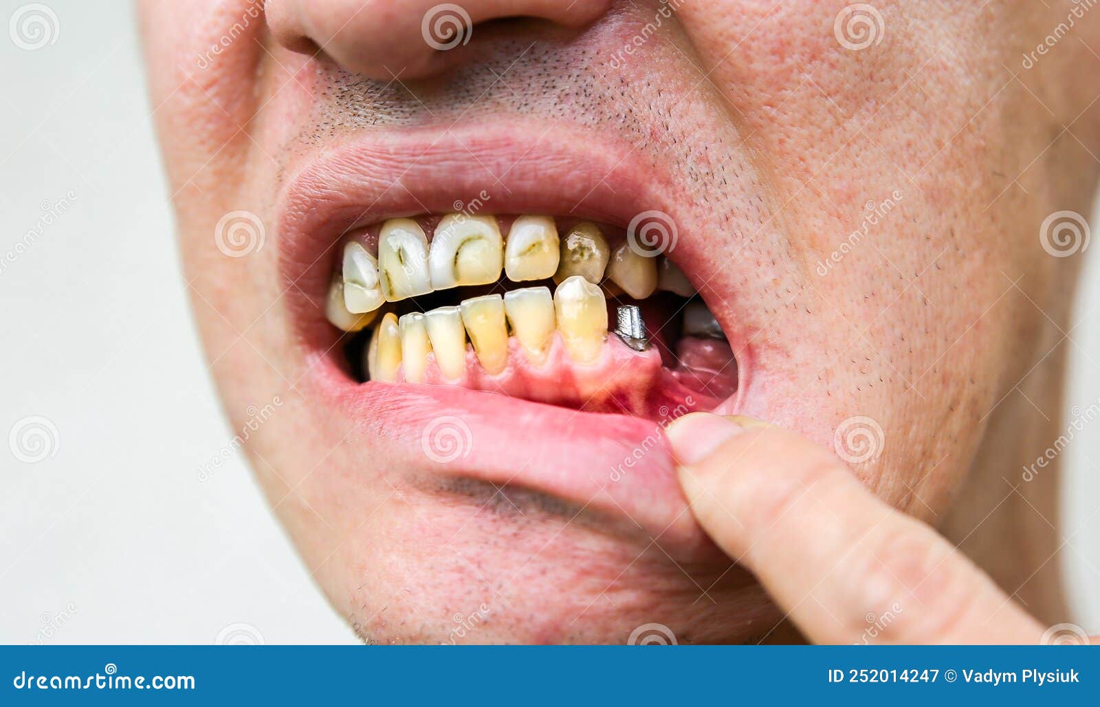 Teeth Implantation. Dental Post Preparation Stock Image - Image of ...