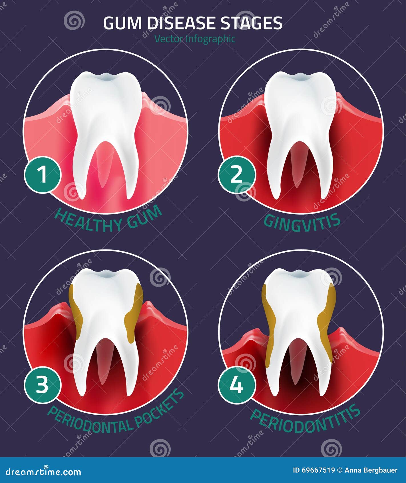 Teeth Infographic Gum Disease Stages Stock Vector - Illustration of ... Teeth Infographic Gum Disease Stages Stock Vector - Illustration of ...