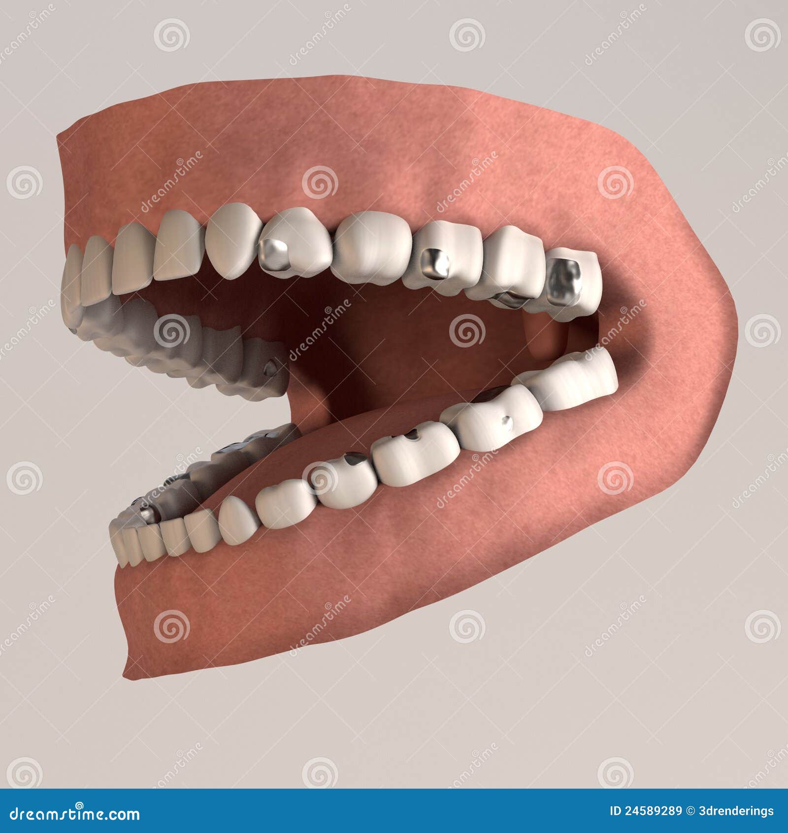 Teeth with lead fillings stock illustration. Illustration of female ...