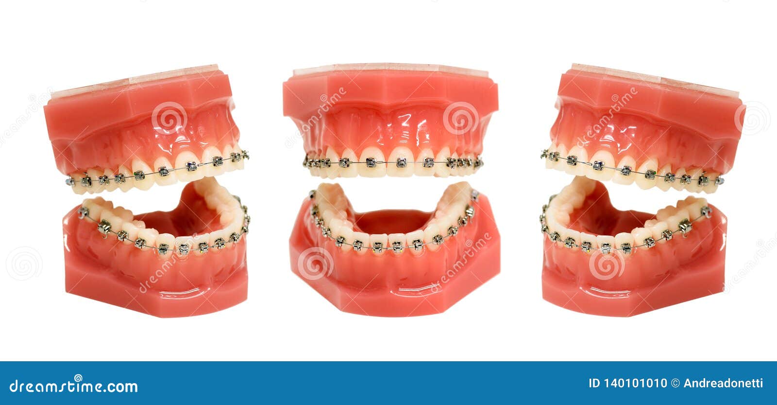 Teeth Model with Wired Dental Braces Stock Photo - Image of teeth ...