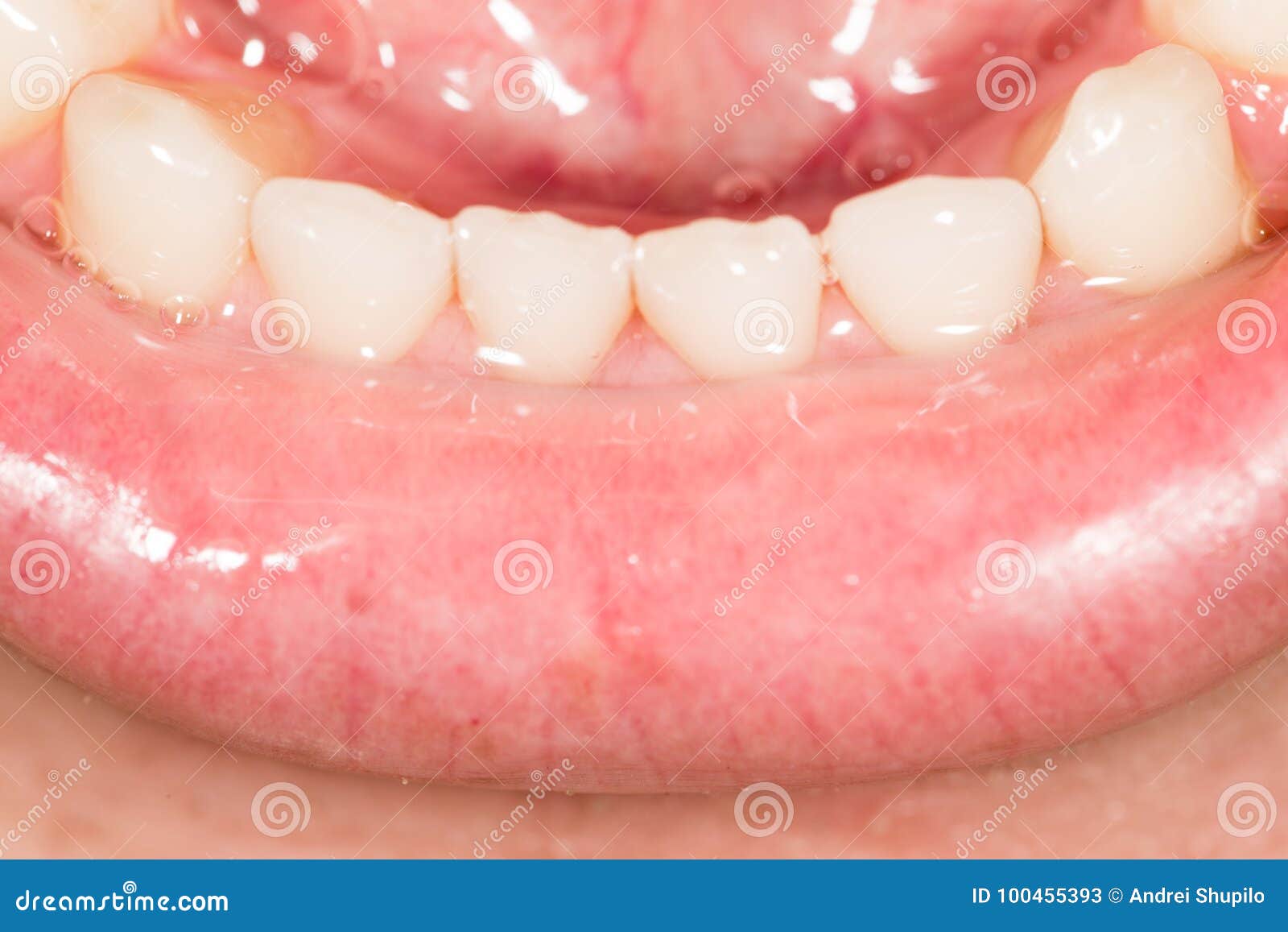 Teeth in the Mouth. Close-up Stock Image - Image of detail, diastema ...