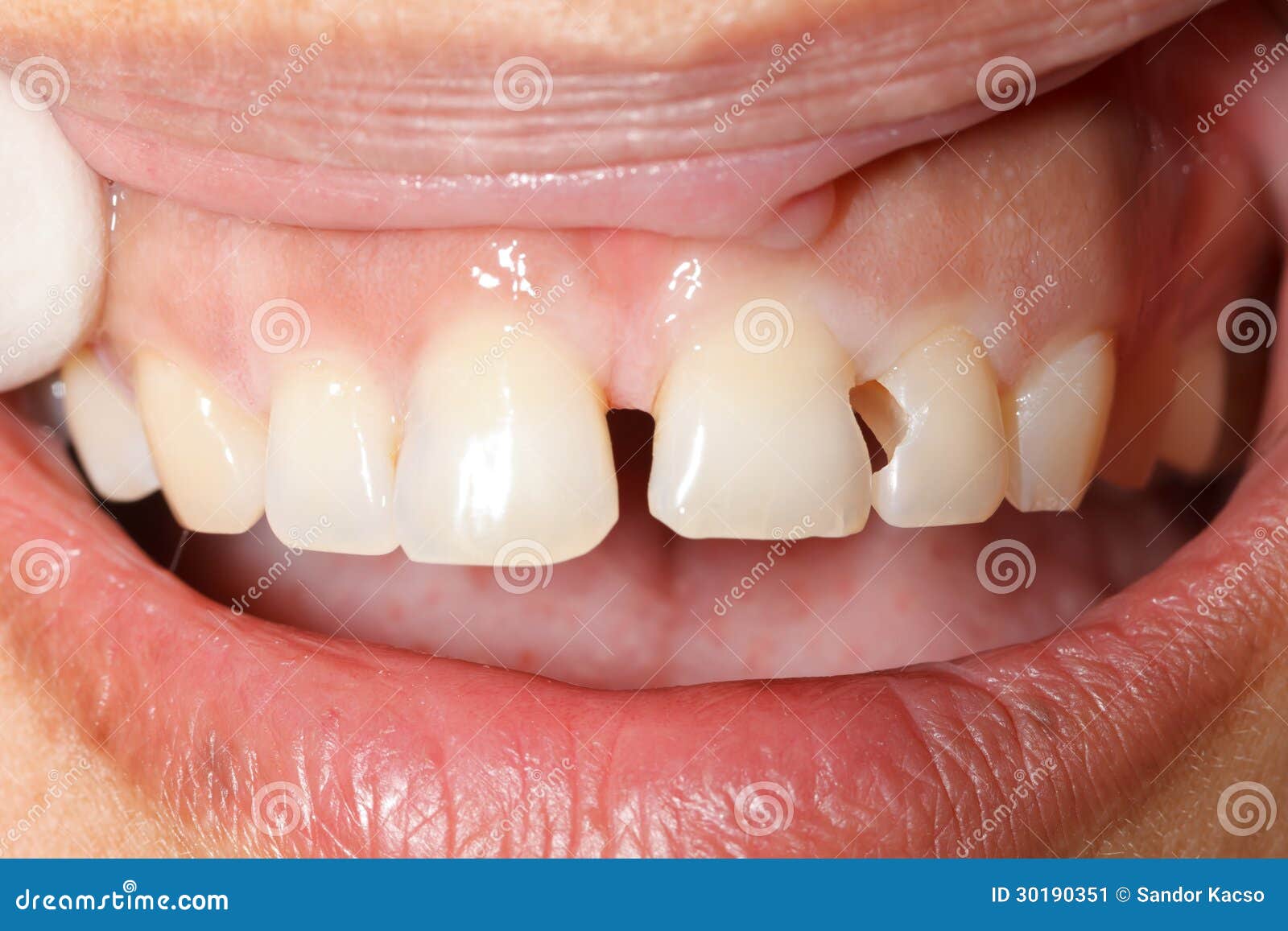 Cleaned dental cavity stock image. Image of health, rehabilitation ...
