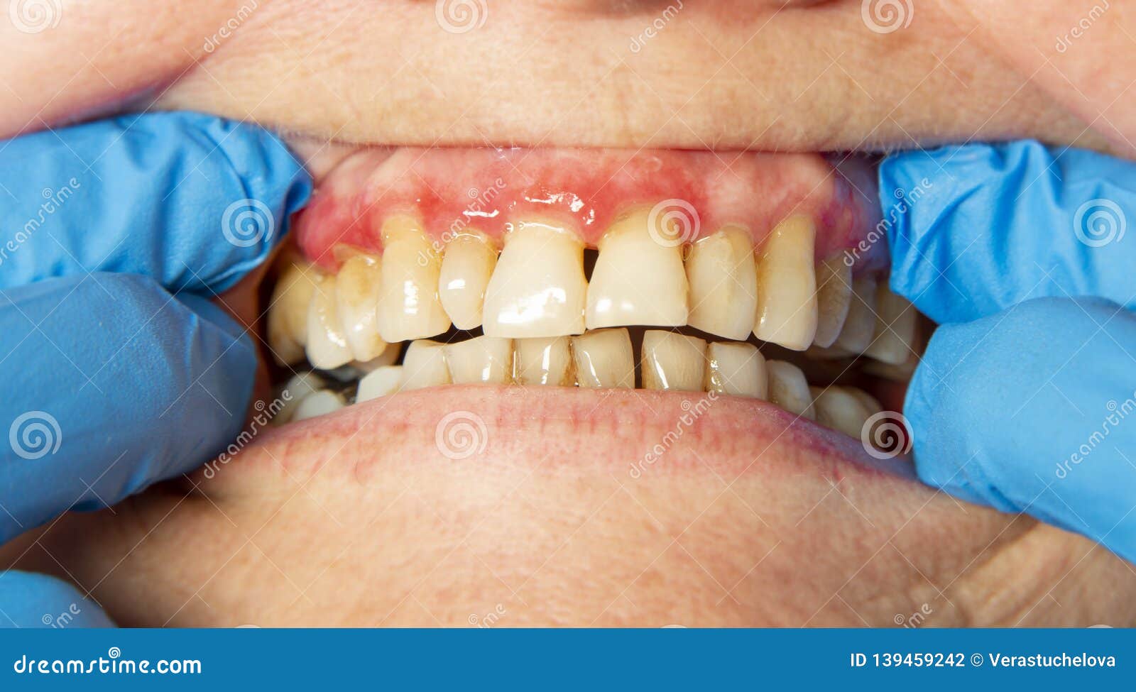 Periodontitis Of A Human Tooth. Endodontics Treatment In The Dental ...