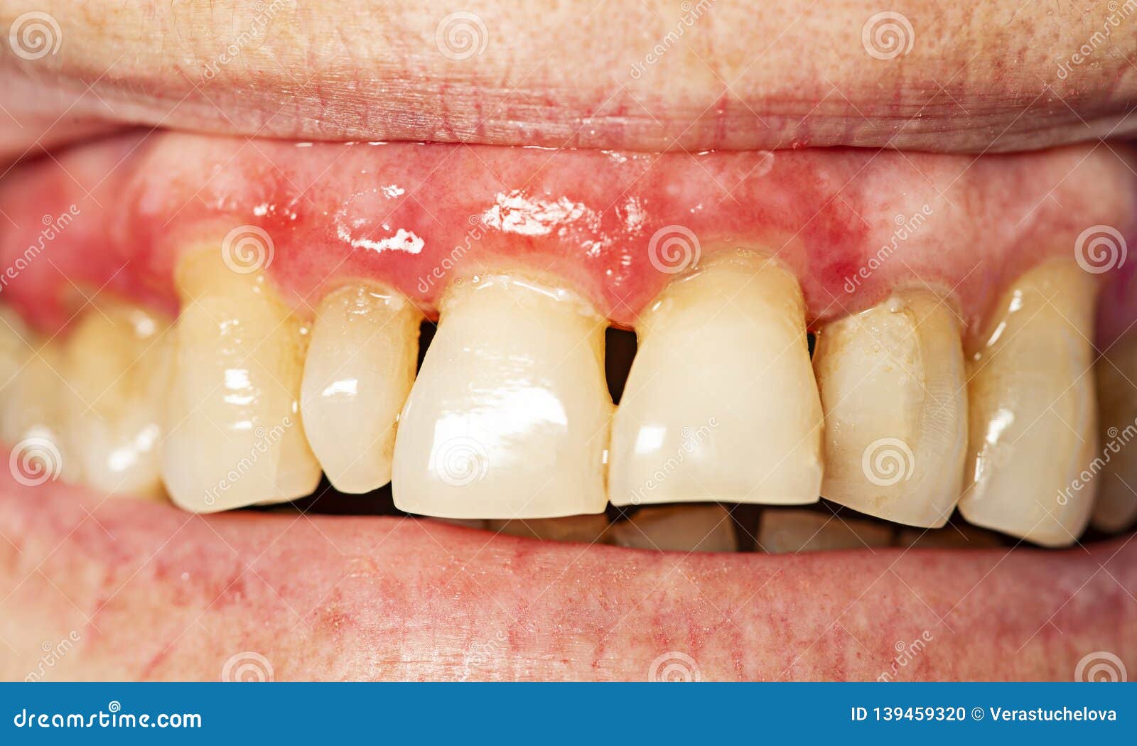 Teeth with periodontitis stock photo. Image of closeup - 139459320