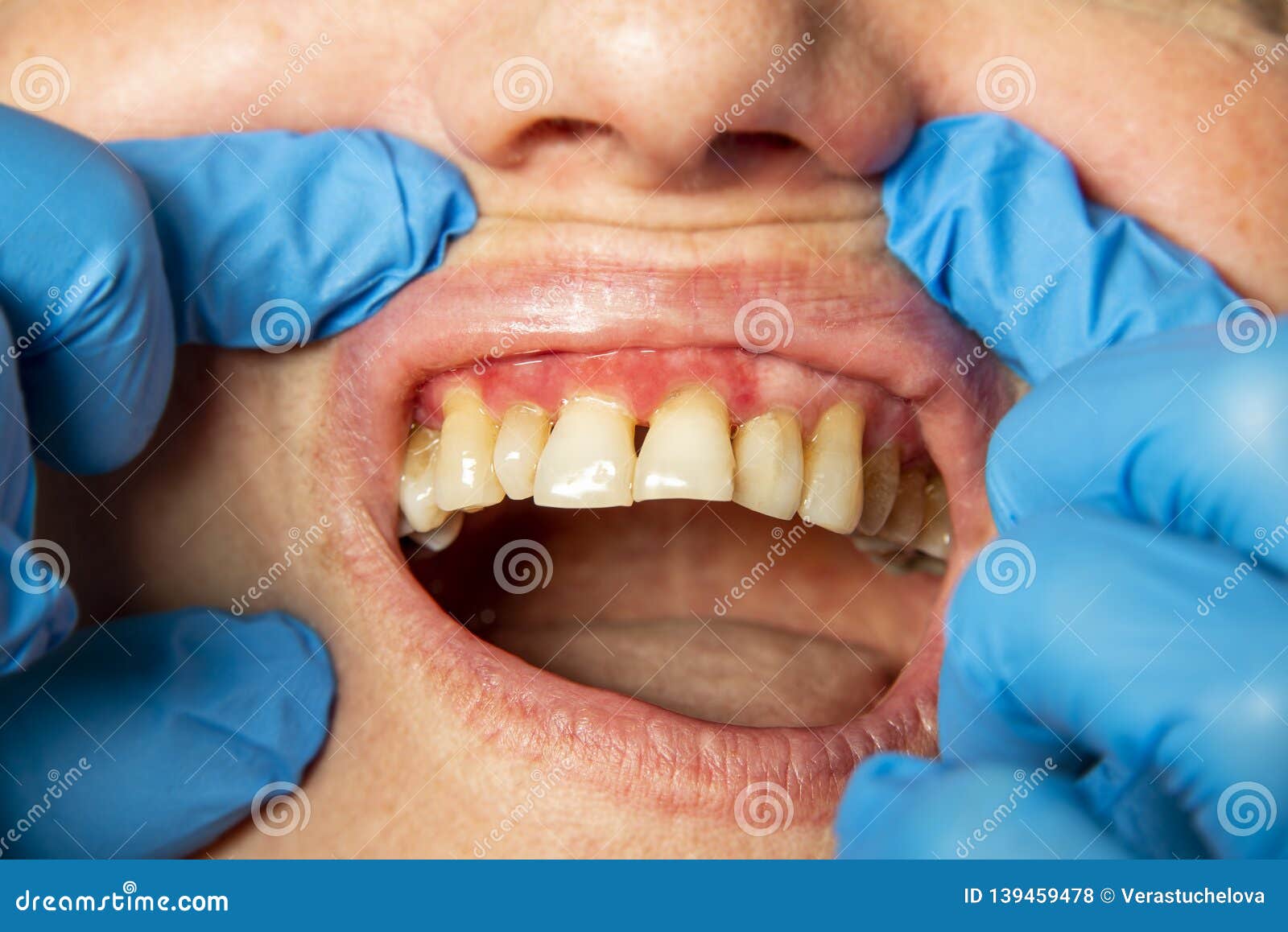 Teeth with periodontitis stock photo. Image of closeup - 139459478