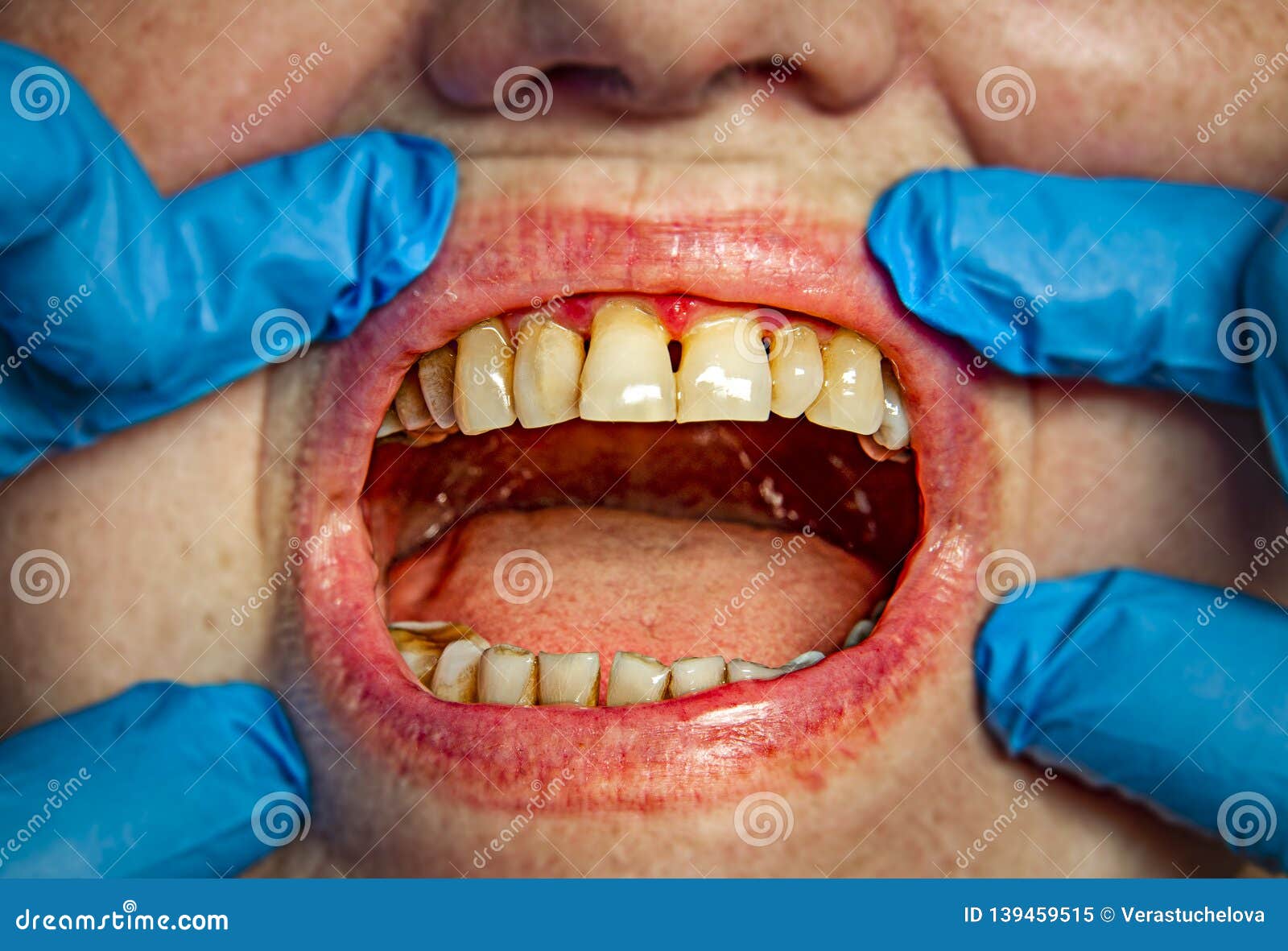 Periodontitis Of A Human Tooth. Endodontics Treatment In The Dental ...