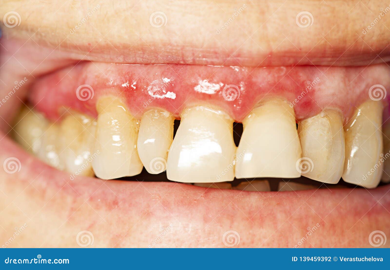 Periodontitis Of A Human Tooth. Endodontics Treatment In The Dental ...