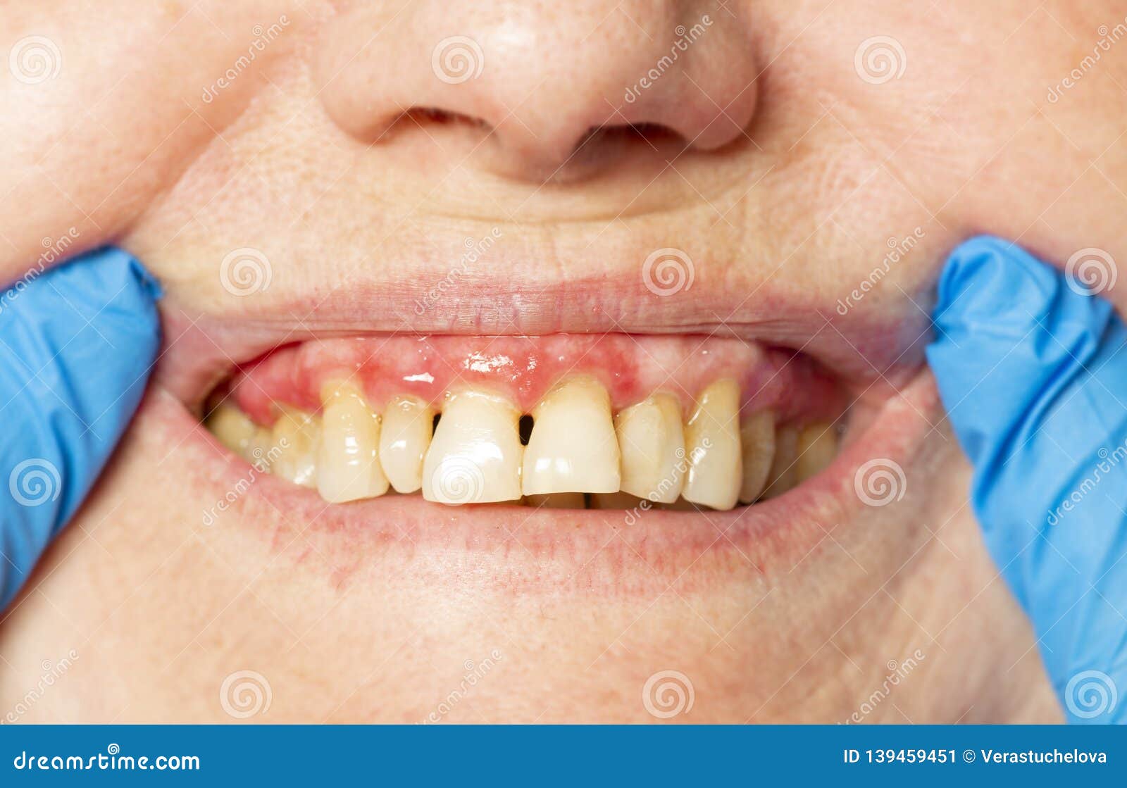 Teeth with periodontitis stock image. Image of clinic - 139459451