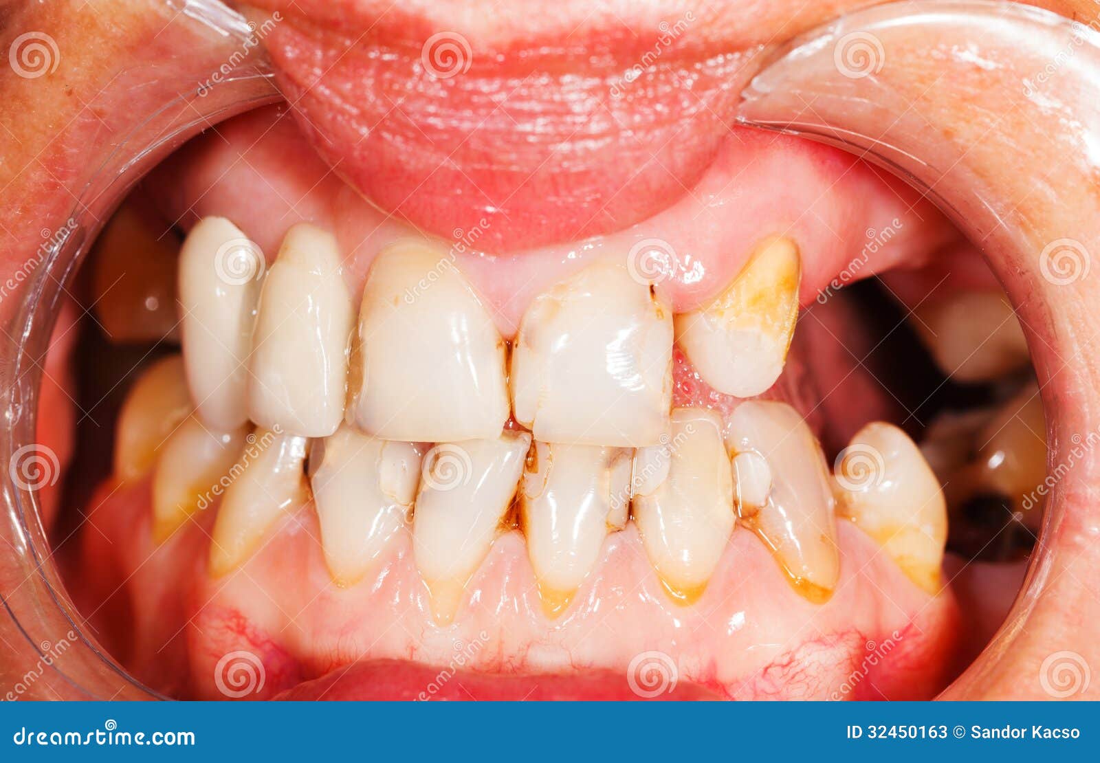 Teeth stock image. Image of product, stitch, stitches - 32450163