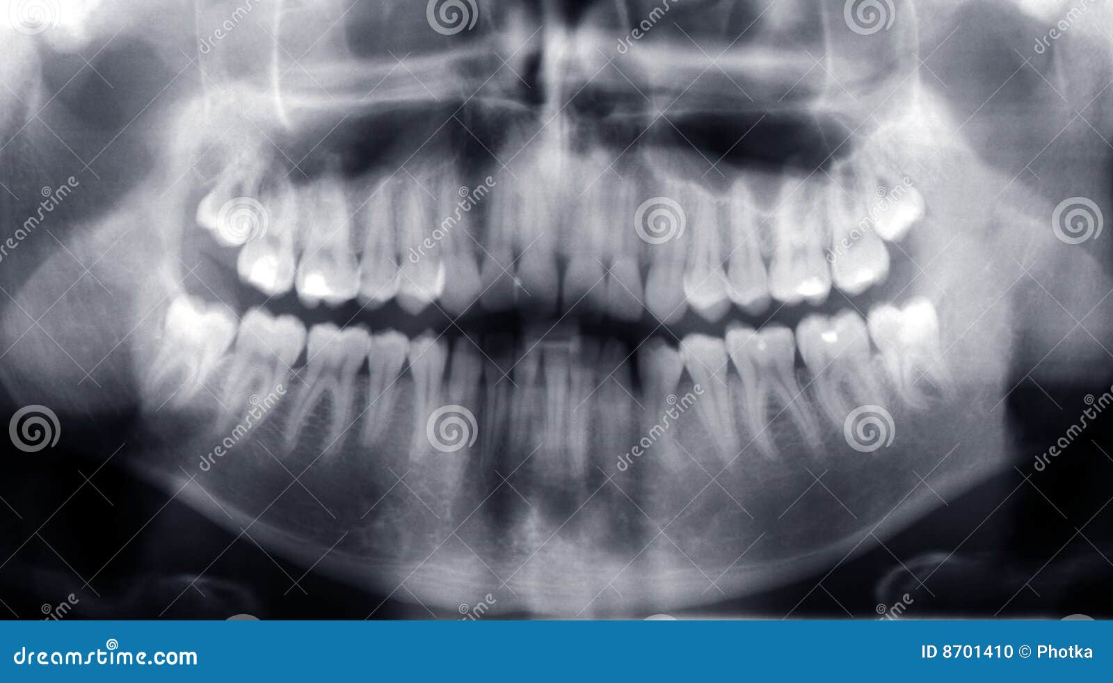 Teeth x-ray stock photo. Image of reconstruction, operation - 8701410