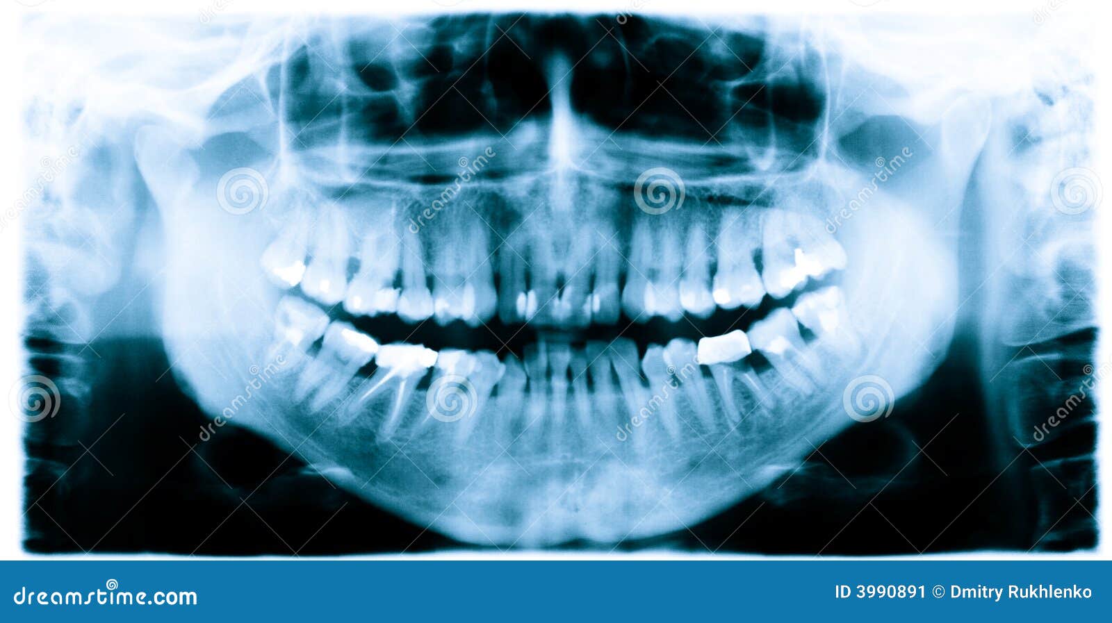 Teeth x-ray image stock image. Image of tooth, dental - 3990891