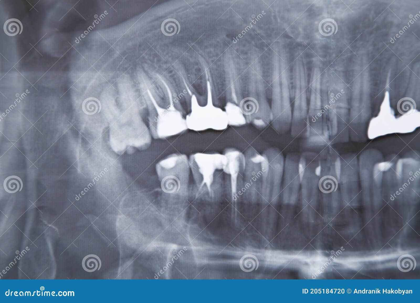 Teeth X-ray Image. Scan of Teeth Stock Photo - Image of removal ...