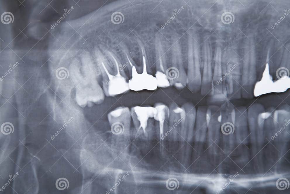 Teeth X-ray Image. Scan of Teeth Stock Photo - Image of removal ...