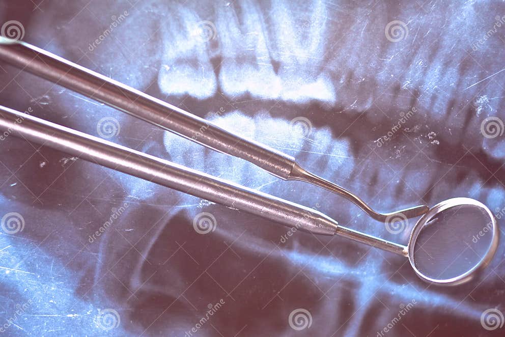 Teeth X-ray Showing Problem with Infected Gum and Stock Photo - Image ...