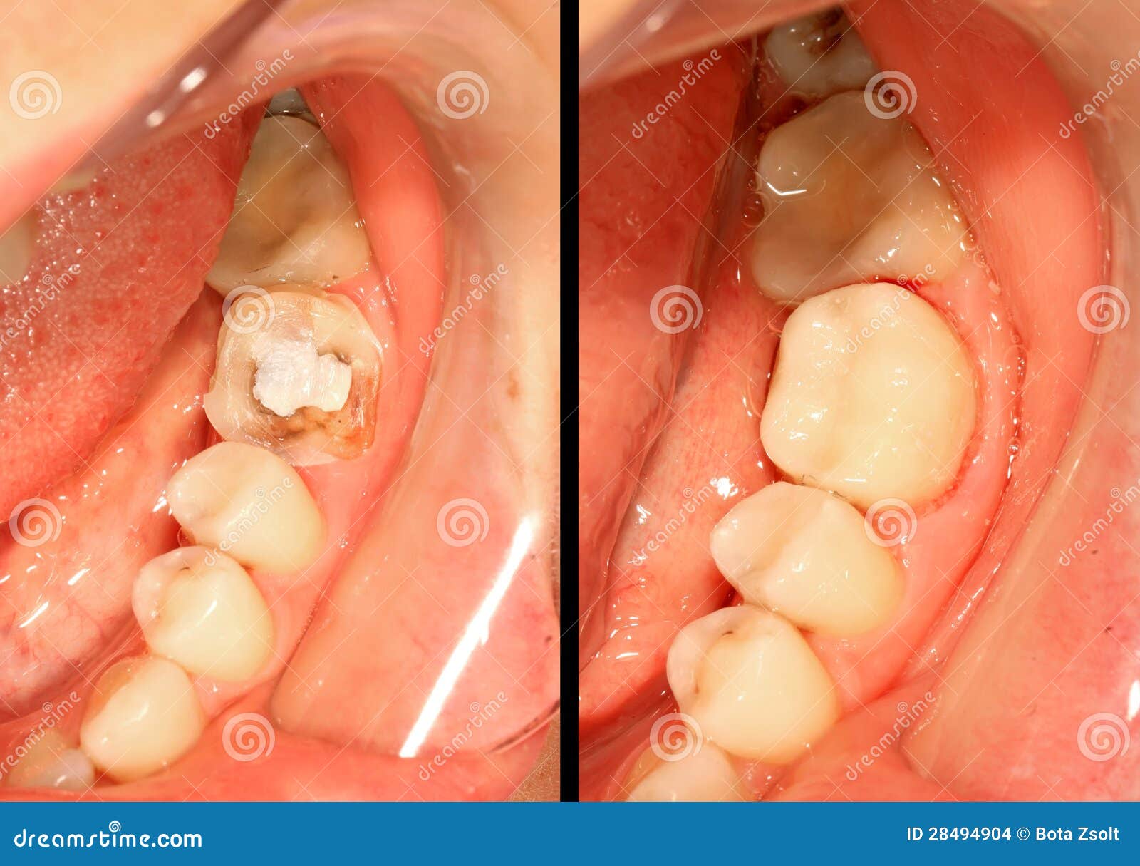 Teeth restoration stock photo. Image of dental, clinical - 28494904